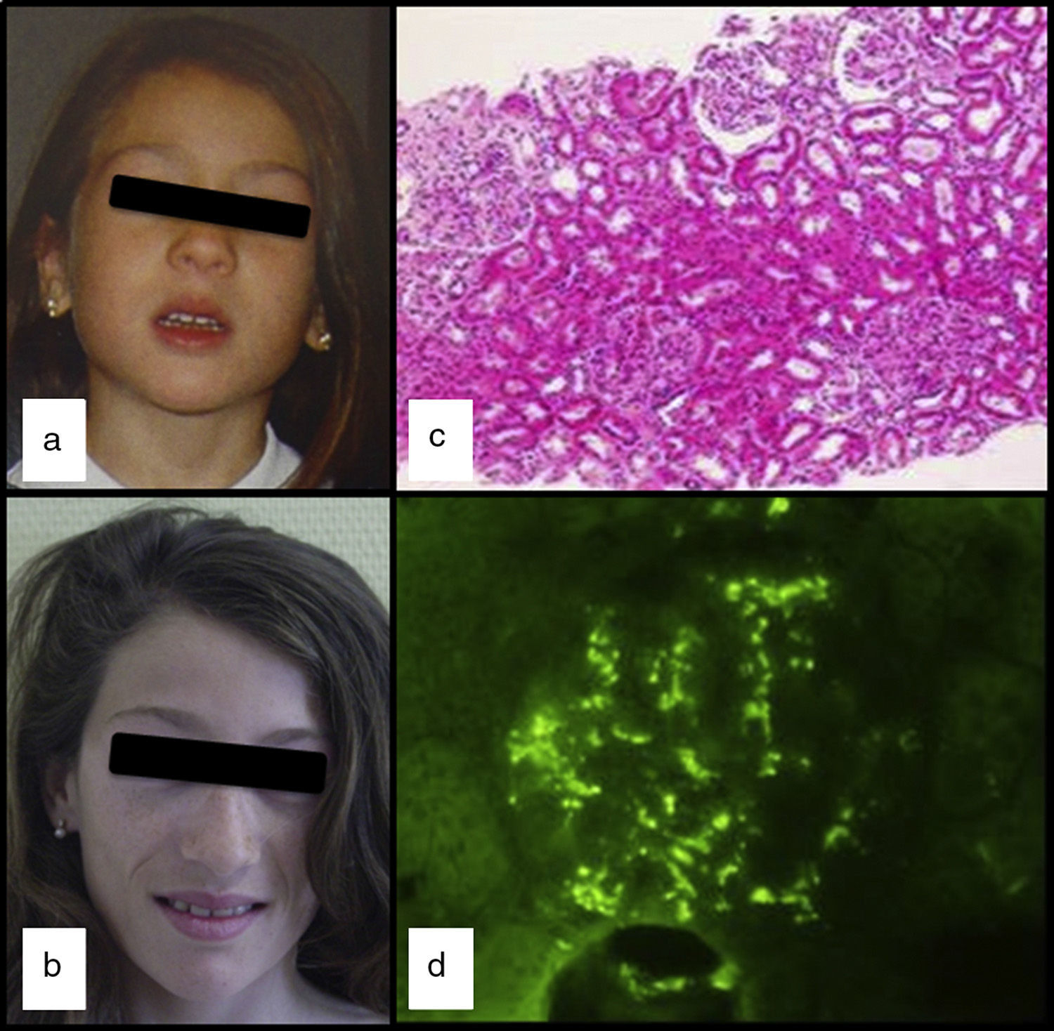 Acquired partial lipodystrophy (Barraquer–Simons syndrome) and IgA ...