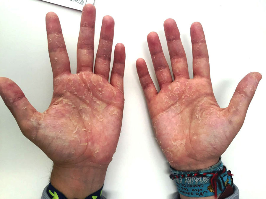 Skin reactions with the use of icodextrin in peritoneal dialysis ...