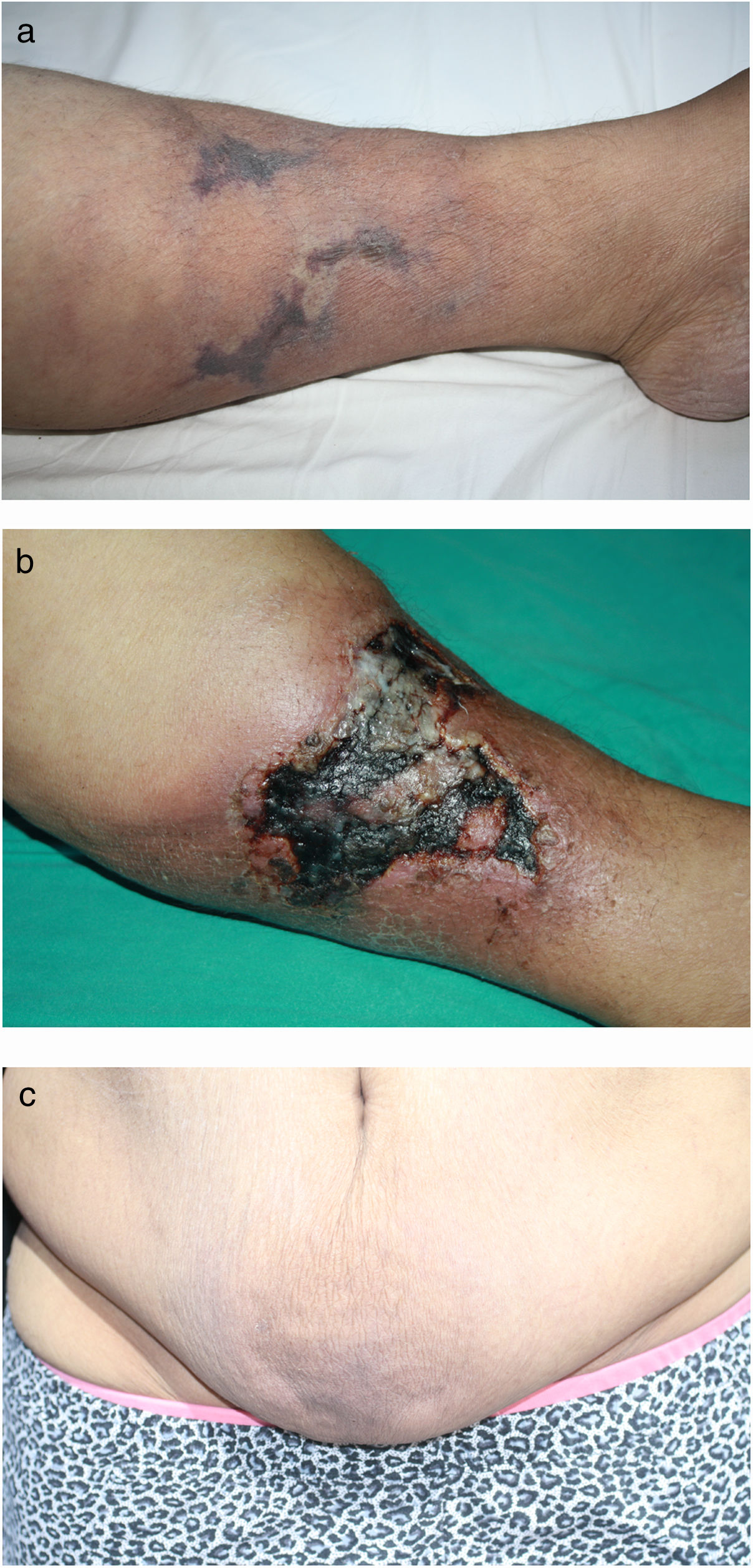 early calciphylaxis