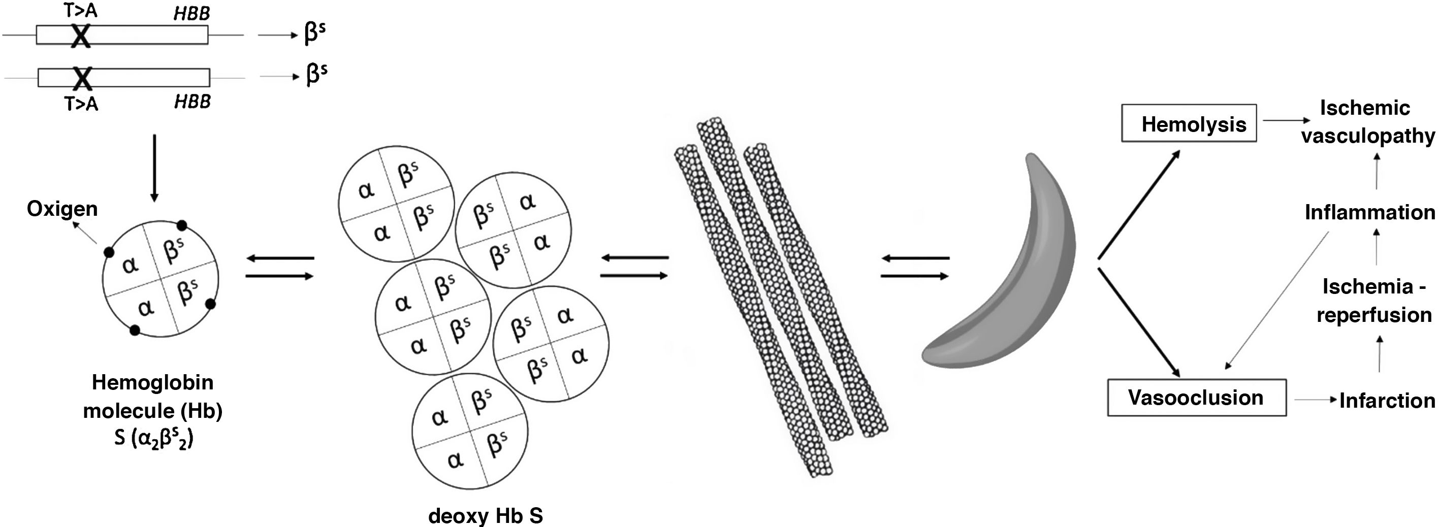 Sickle cell nephropathy. Clinical manifestations and new mechanisms ...