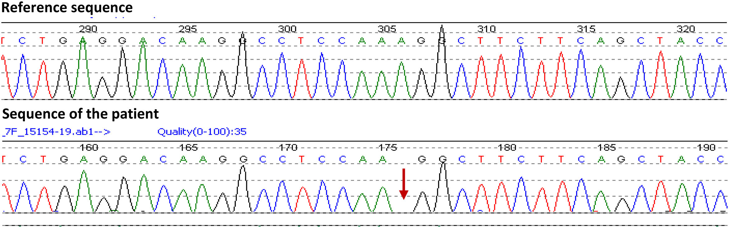 Gitelman syndrome – A new mutation in the SLC12A3 gene | Nefrología