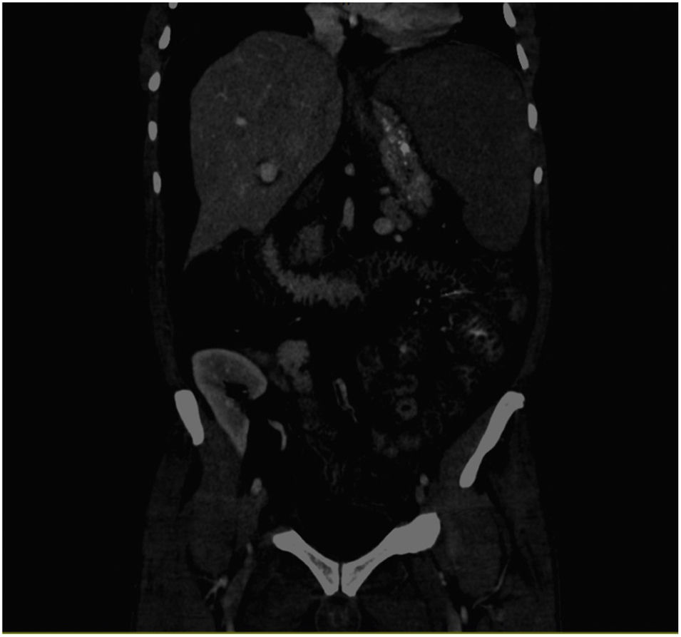 Portal hypertension and gastrointestinal bleeding in a kidney ...