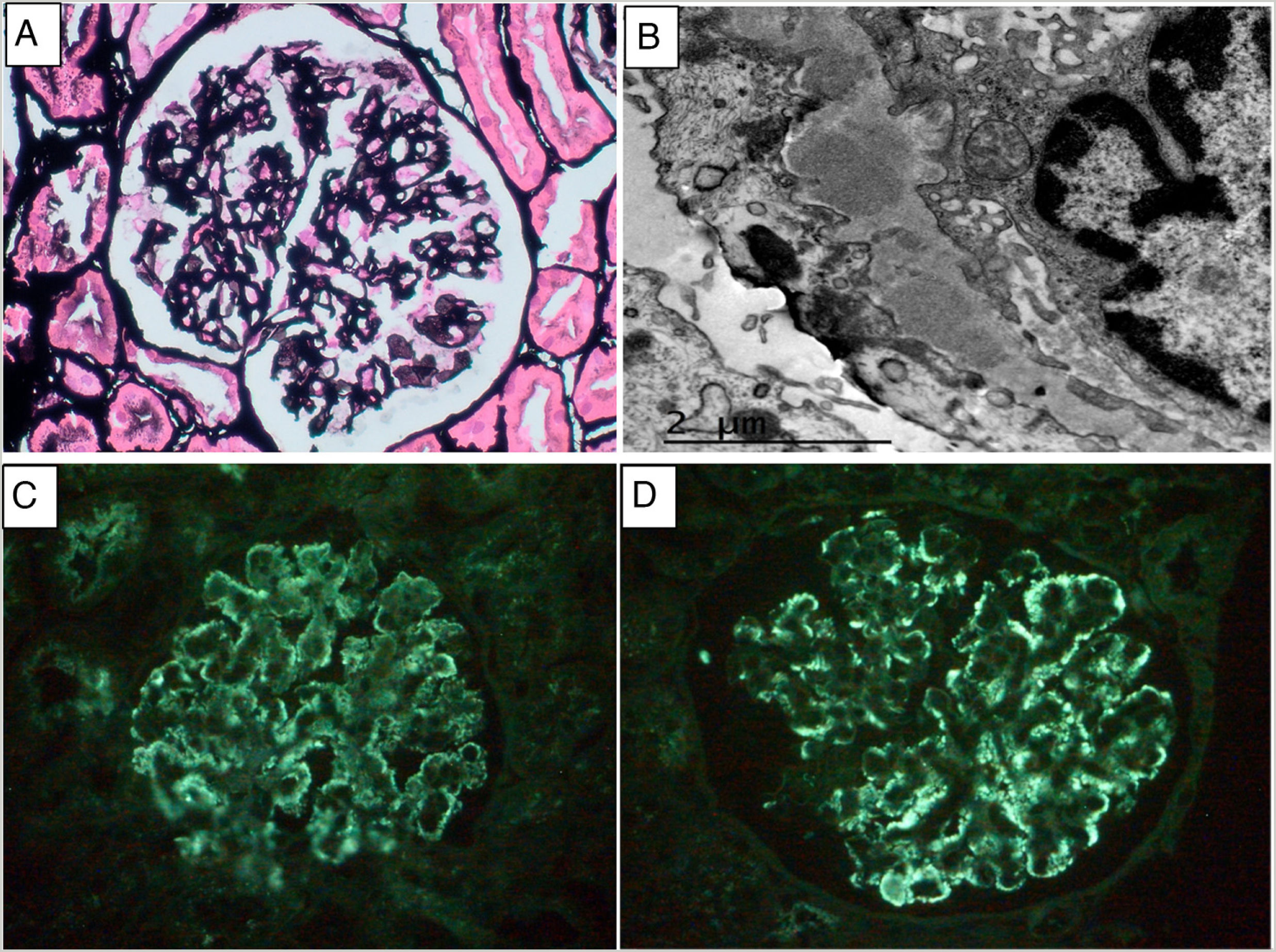 diffuse proliferative glomerulonephritis em