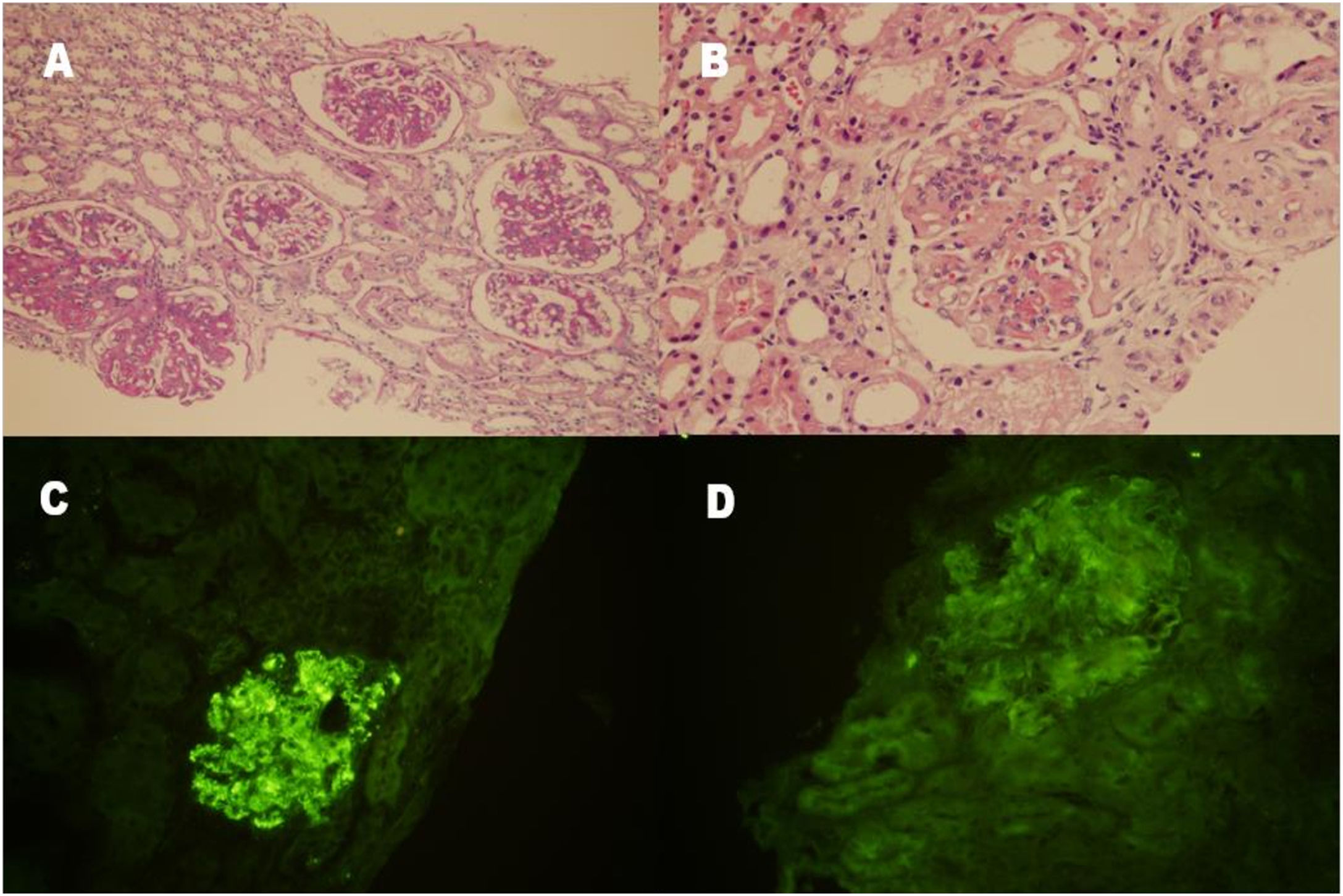 A rare co-existence of celiac disease and C3 glomerulopathy | Nefrología