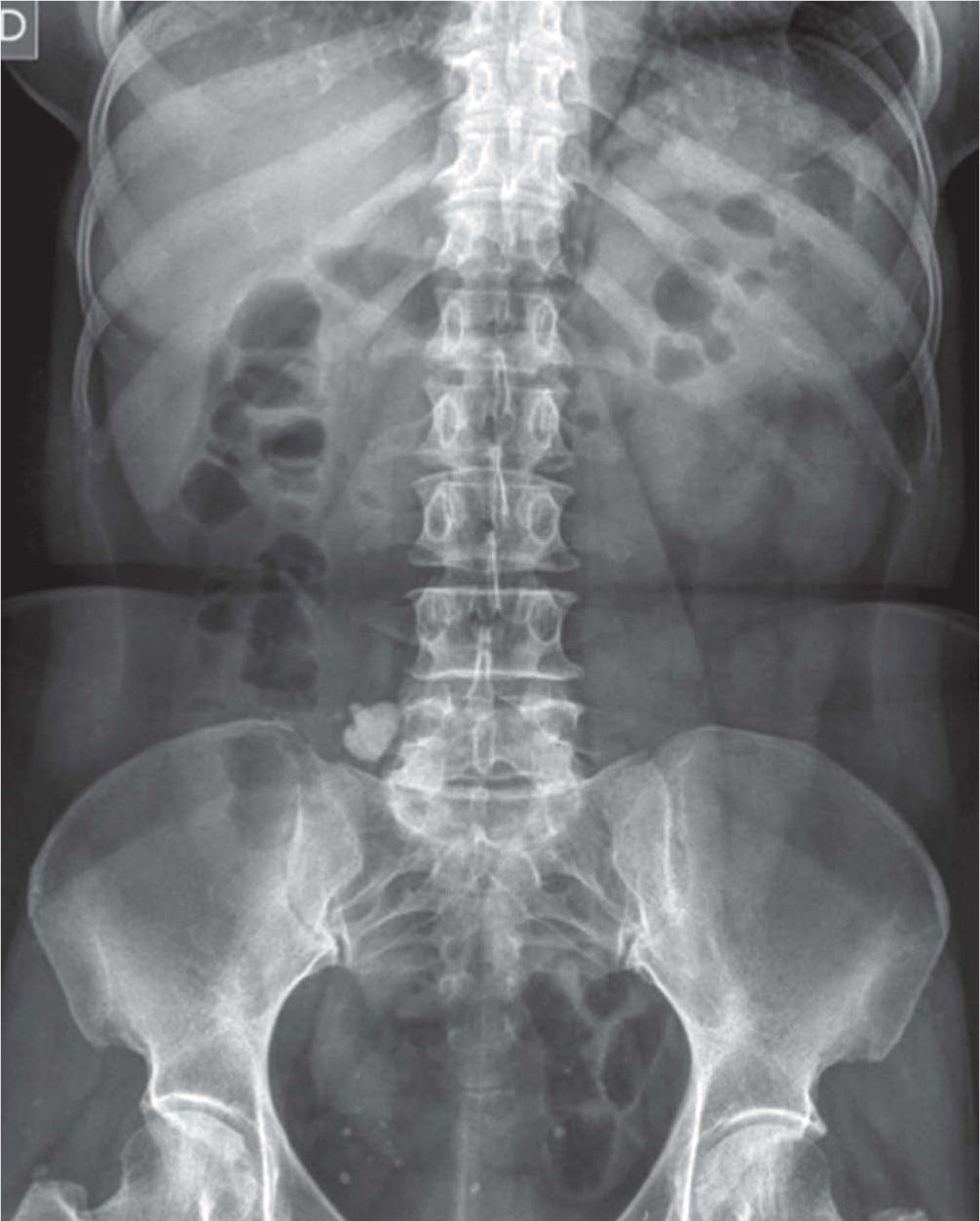 Ectasia ureteral secundaria a textiloma abdominal | Imagen Diagnóstica