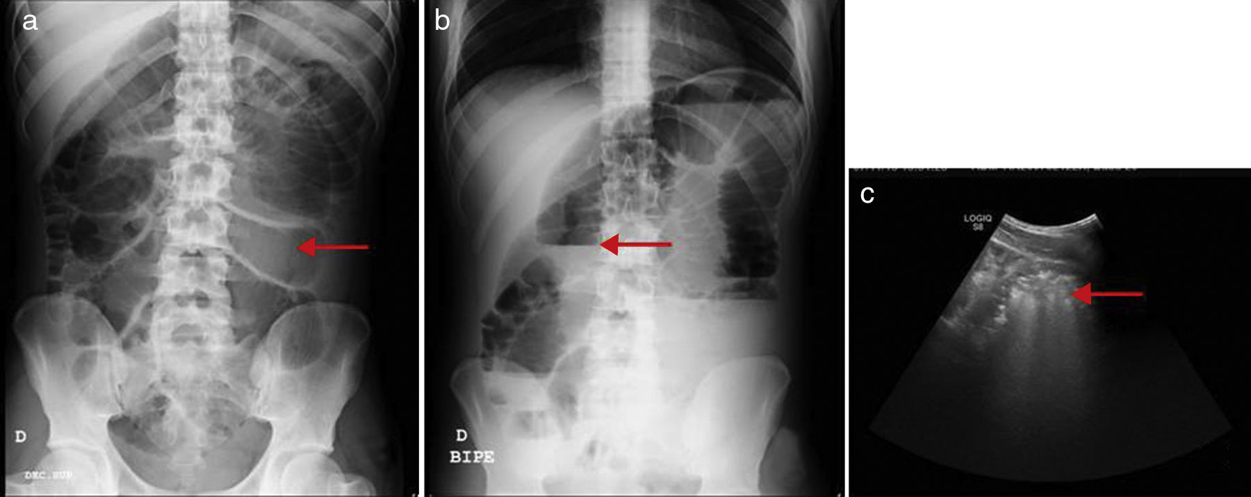 Fitobezoar intestinal | Imagen Diagnóstica