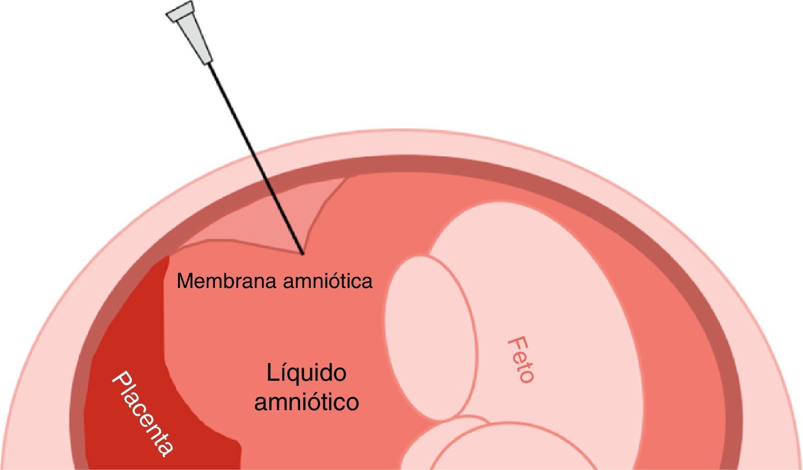Amniocentesis: guía práctica | Diagnóstico Prenatal