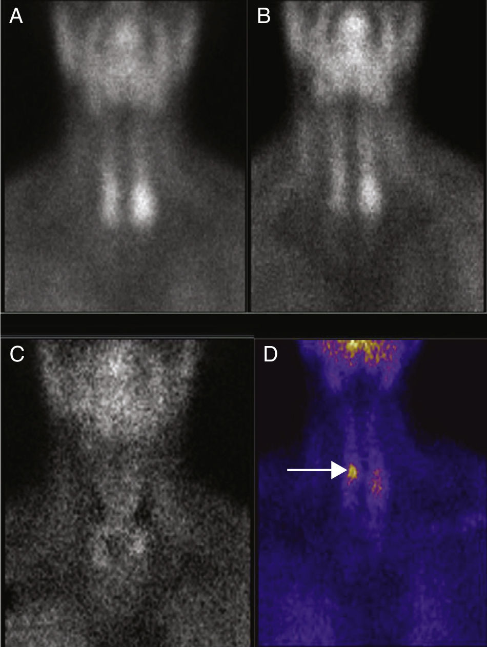 parathyroid mibi scan