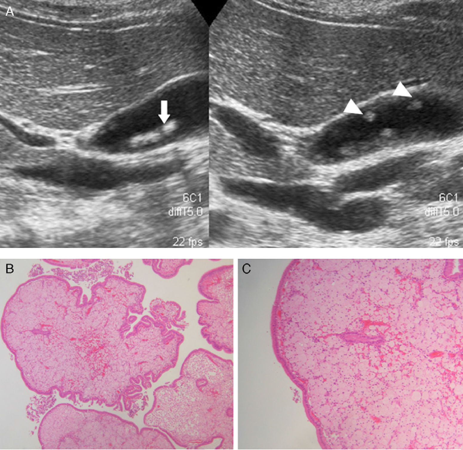 sessile polyp gallbladder