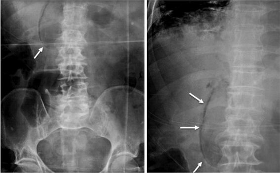cholecystitis x ray