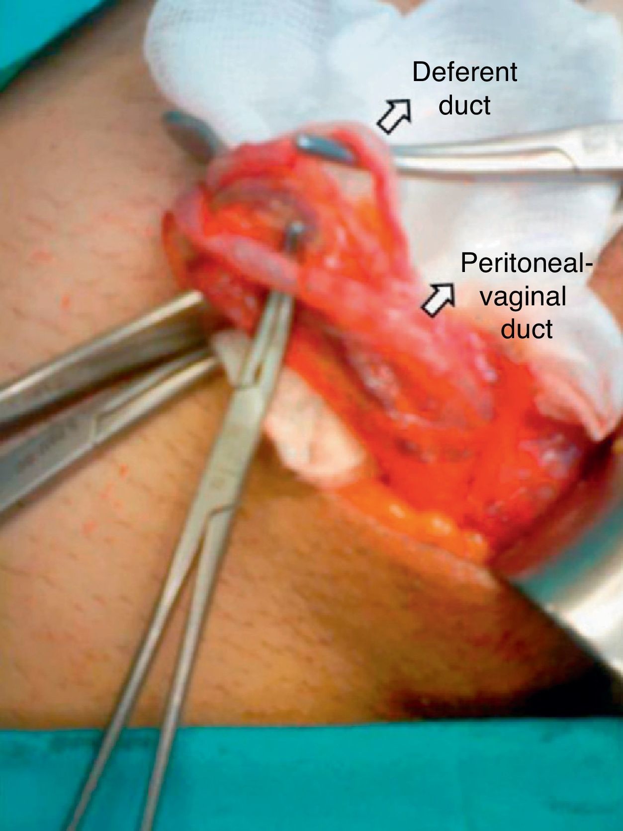 hydrocele surgery after care