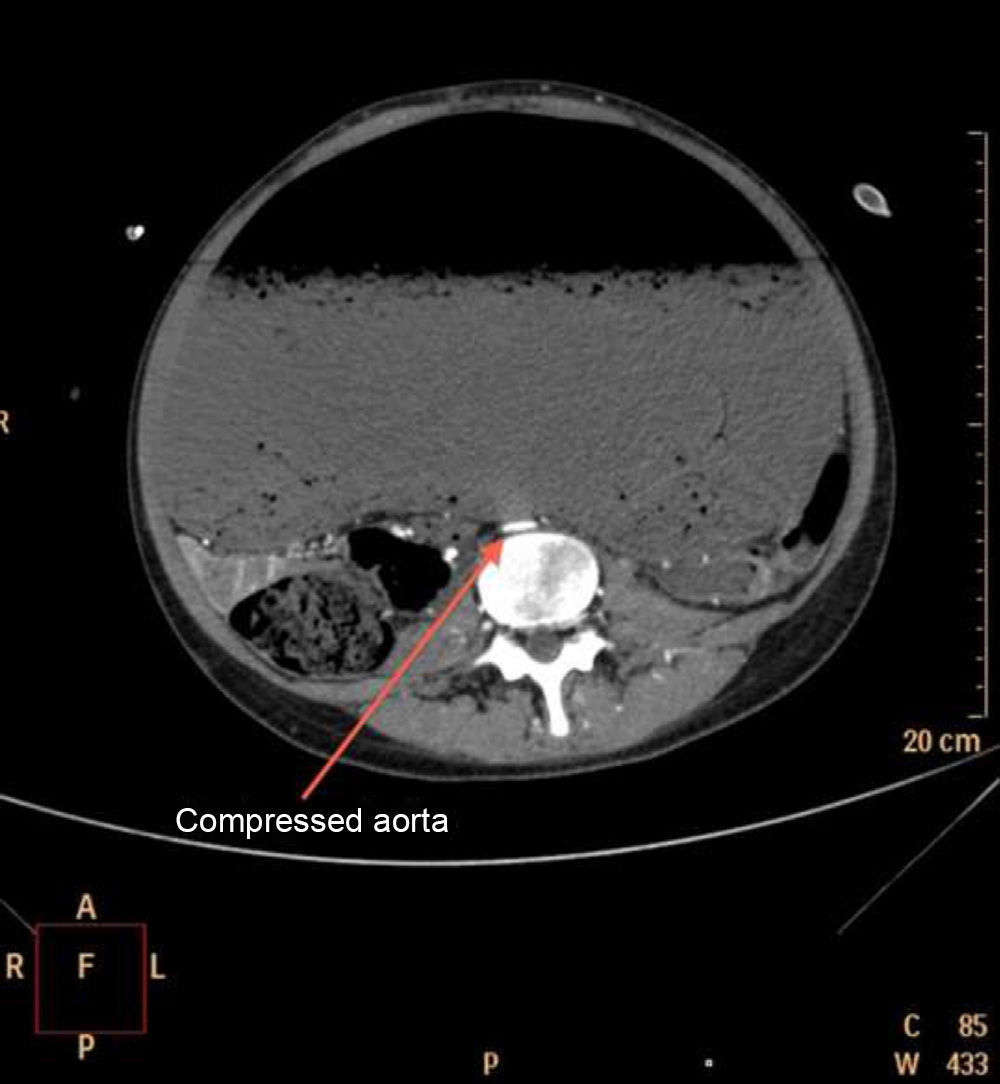 Gigantic Gastric Retention Due to Bulimic Binge Eating | Cirugía ...