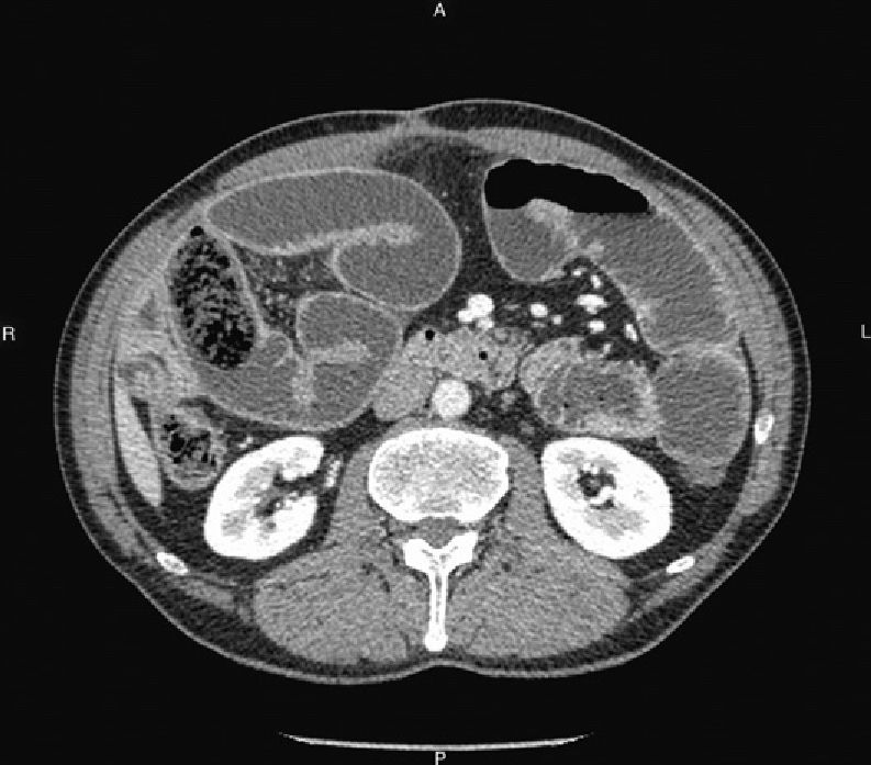 Intestinal Obstruction Caused by Recurrent Phytobezoar: Resolved With ...