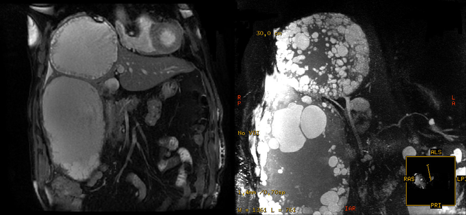 Giant Hepatic Hydatidosis | Cirugía Española (English Edition)