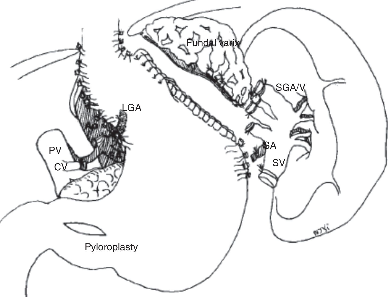 Long Term Results of Periesophagogastric Devascularization (Han ...