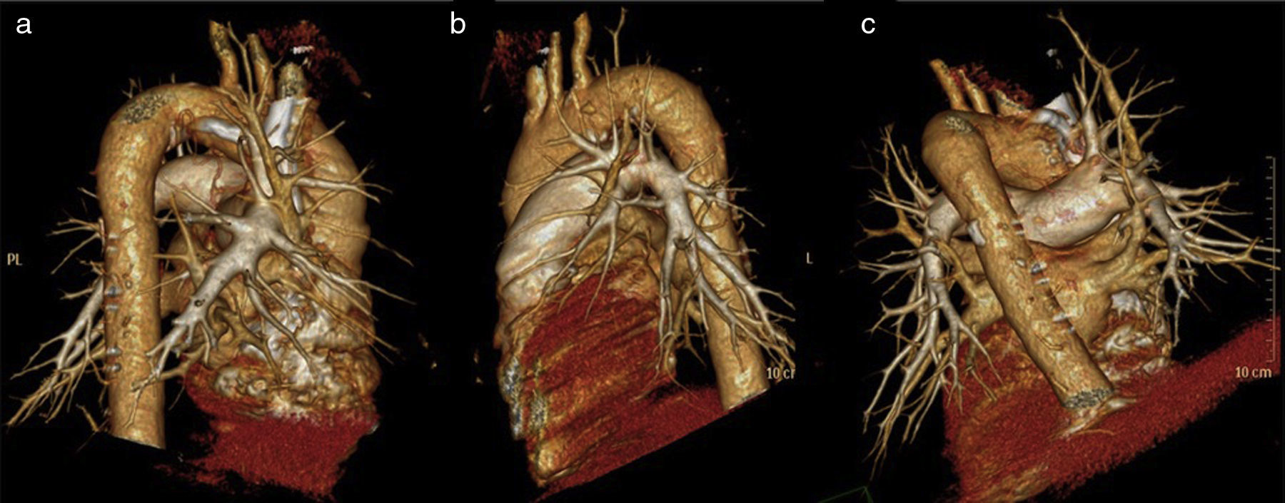 Three Dimensional Computed Tomography for Preoperative Assessment of ...