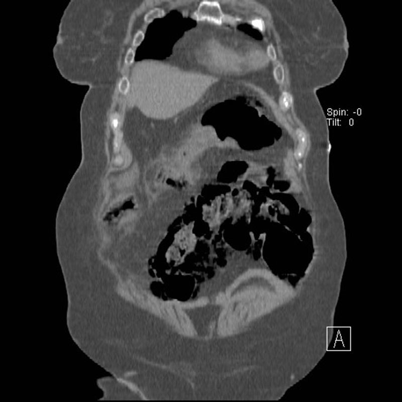 Segmentary Pneumatosis Coli in a Patient With Acute Abdomen | Cirugía ...
