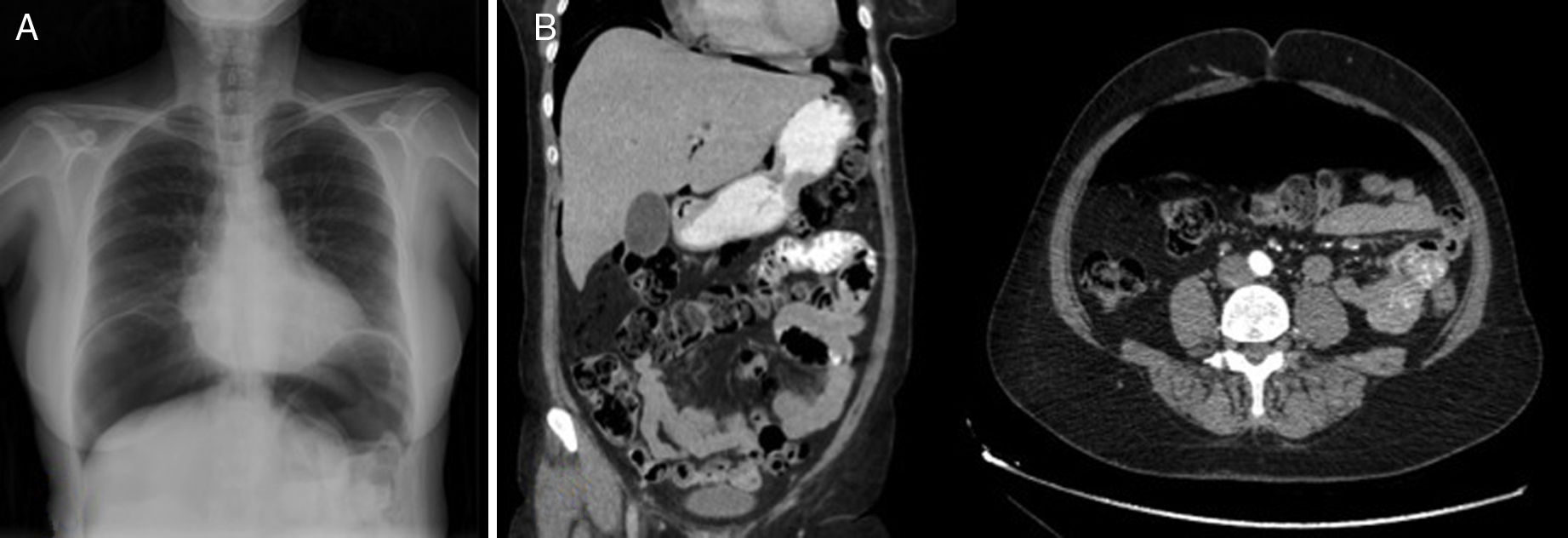Conservative Management of Massive Pneumoperitoneum After Argon Plasma ...
