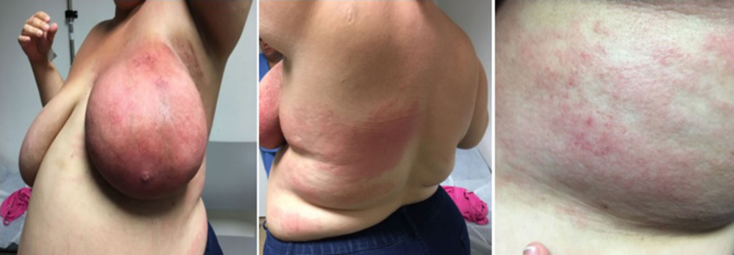 herpes simplex nipple