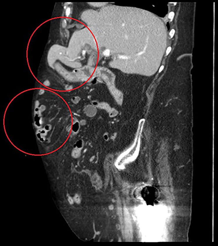 Abdominal eventration with massive visceral content | Cirugía Española ...