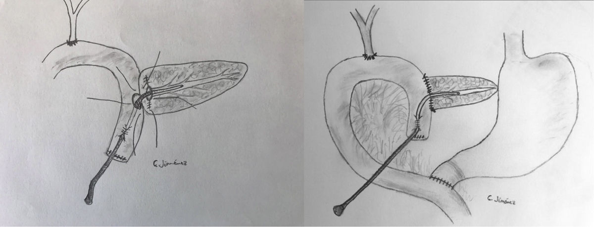 Anastomotic Reconstruction and External Drainage of Wirsung's Duct as ...