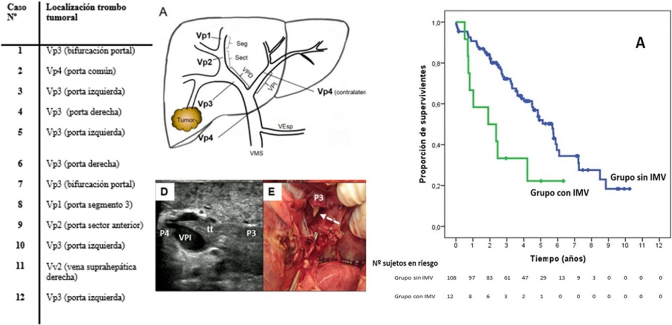 Hepatic Resection With Thrombectomy in the Treatment of Hepatocellular ...