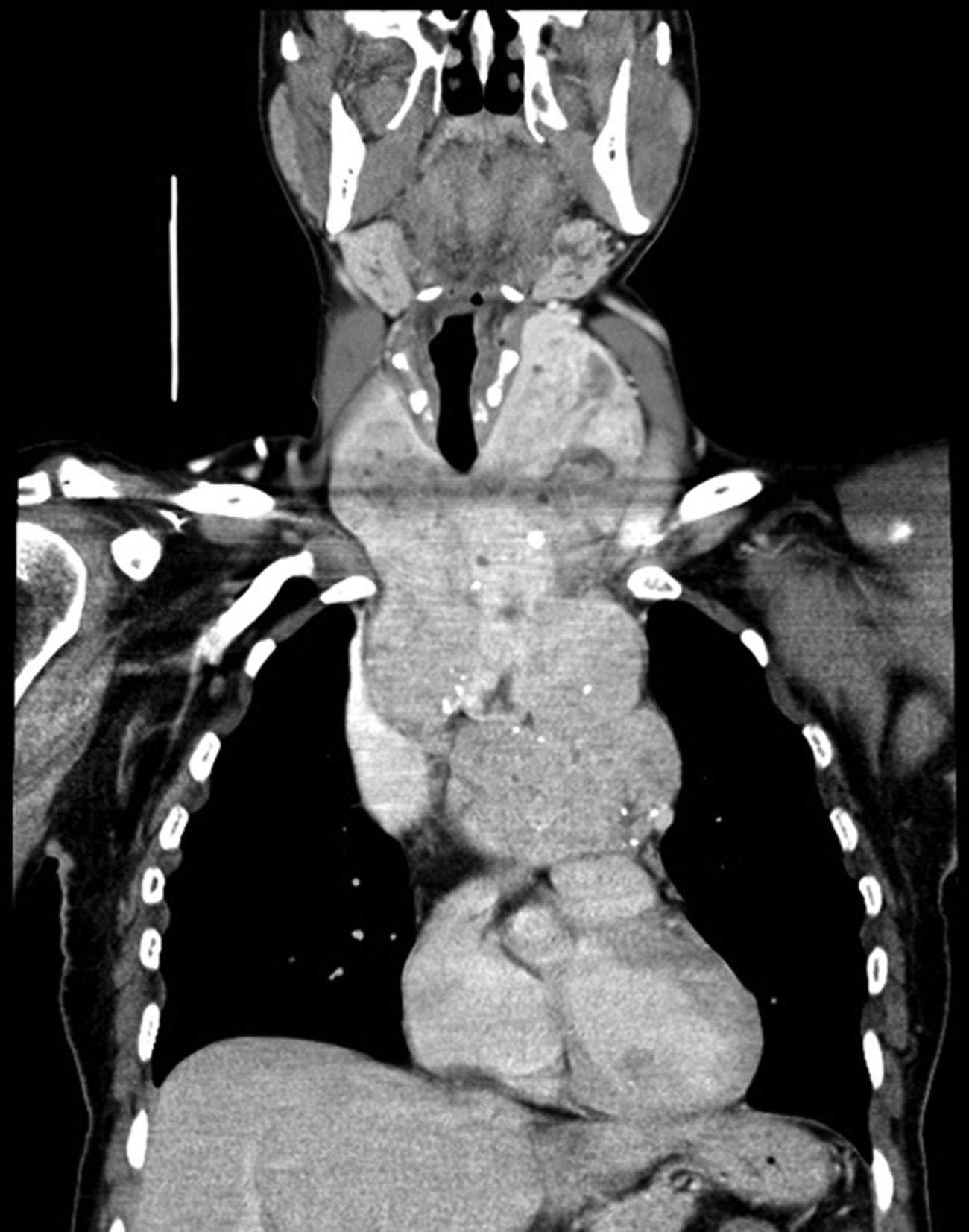 Intrathoracic Multinodular Goiter Surpassing the Aortic Arch | Cirugía ...
