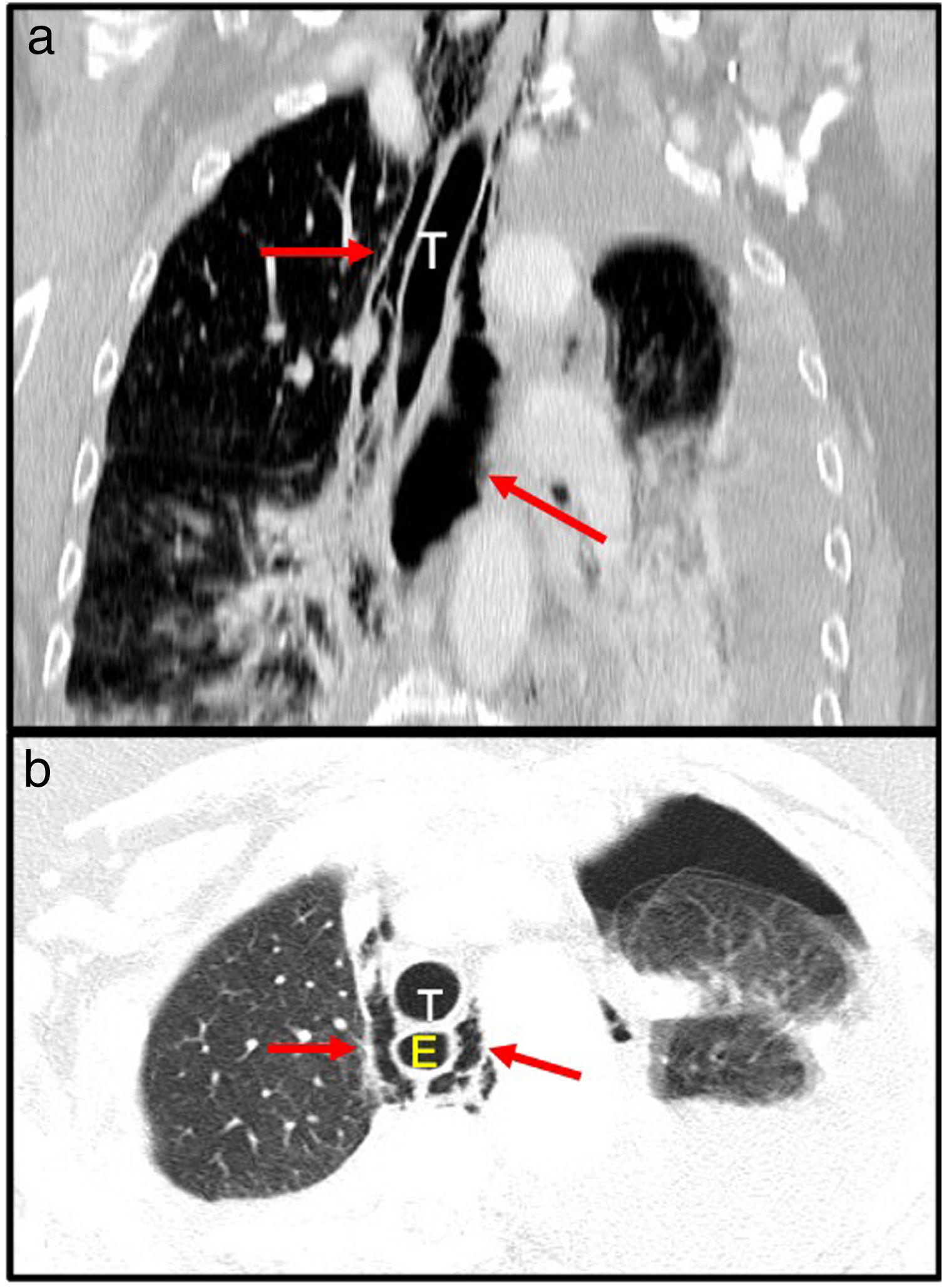 Spontaneous esophageal perforation (Boerhaave syndrome) | Cirugía ...