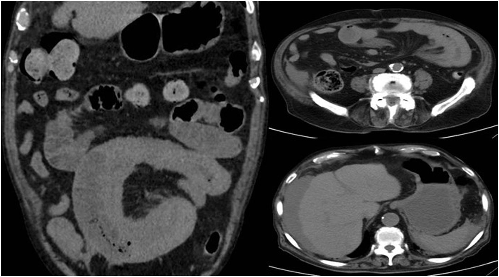 Conservative treatment in spontaneous yeyunal hematoma with moderate ...