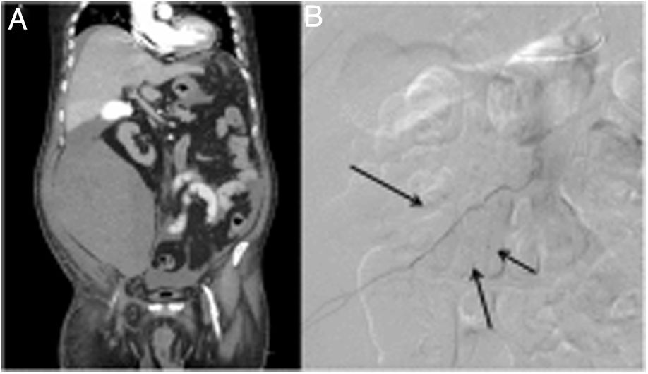 psoas hematoma embolization