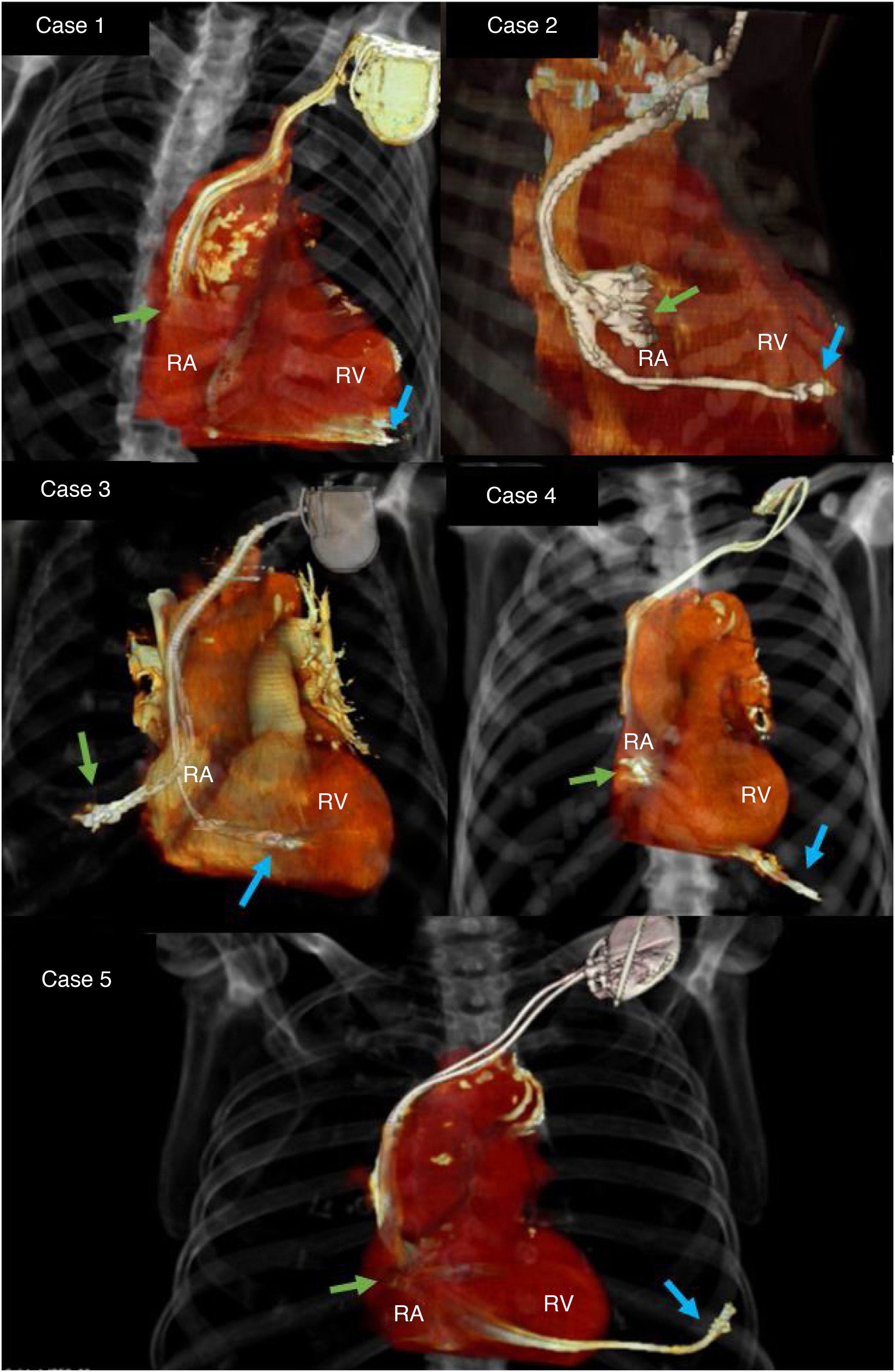 Management of delayed myocardial perforation with a pacing or an ...