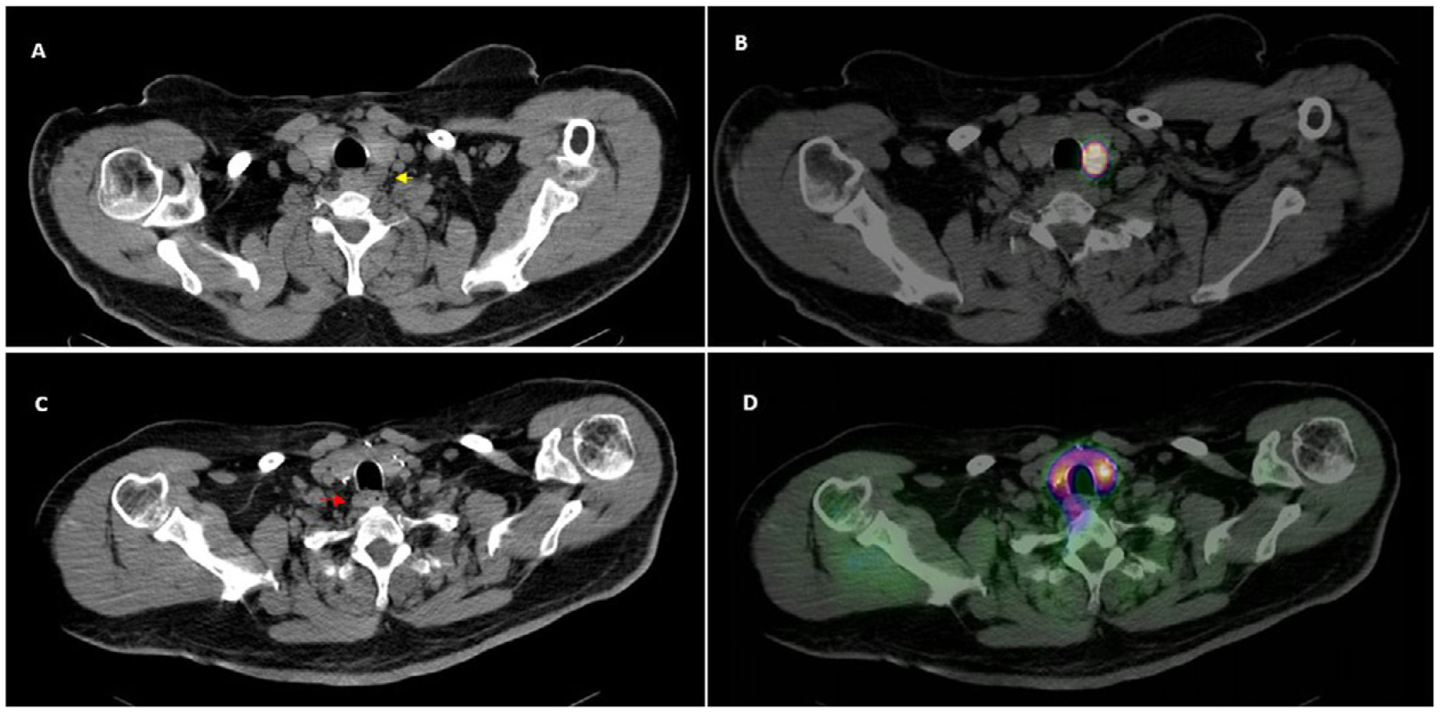 Implementation of a radio-guided selective parathyroidectomy protocol ...