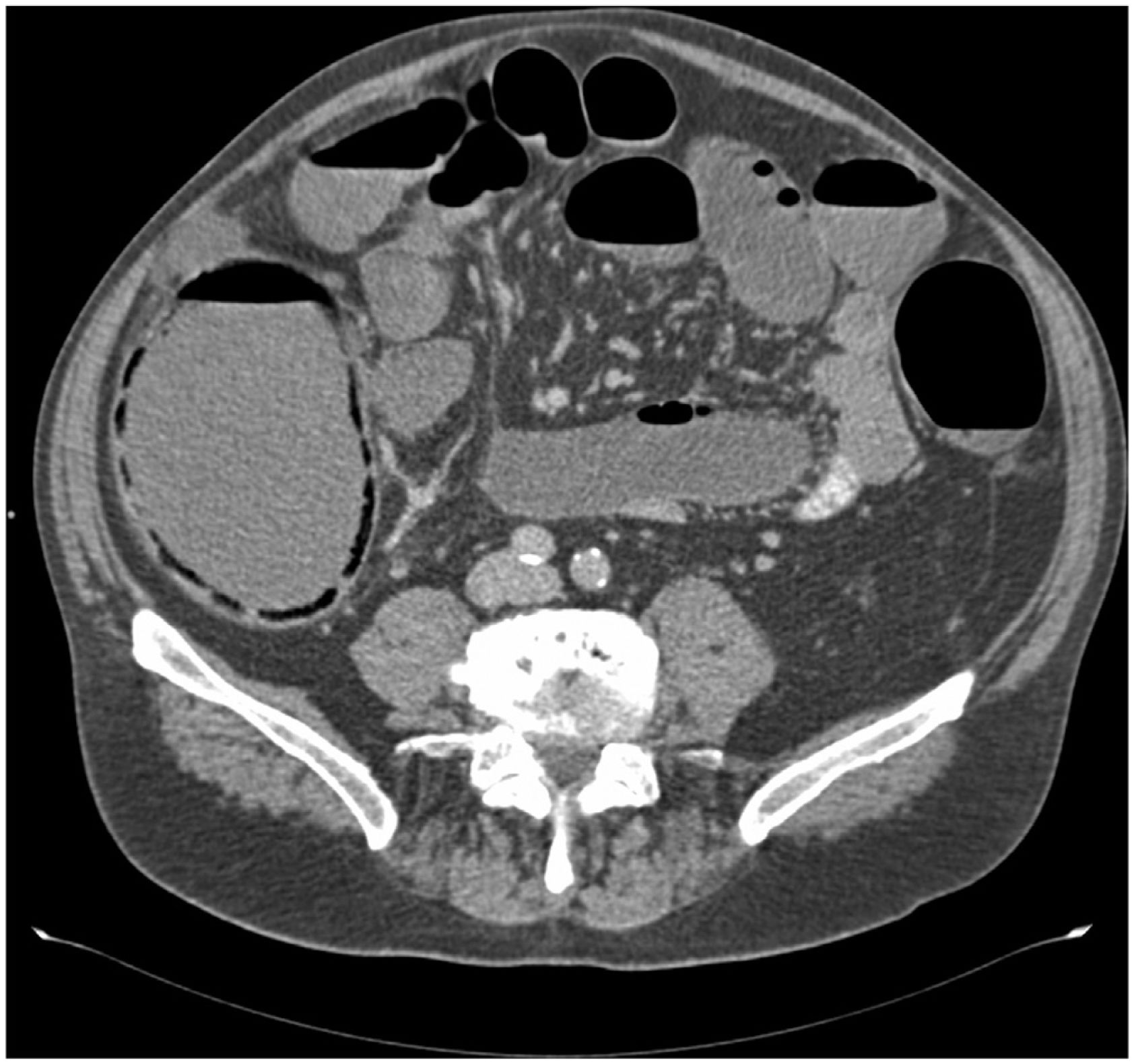 Cecal pneumatosis: Is it a contraindication for an endoscopic self ...