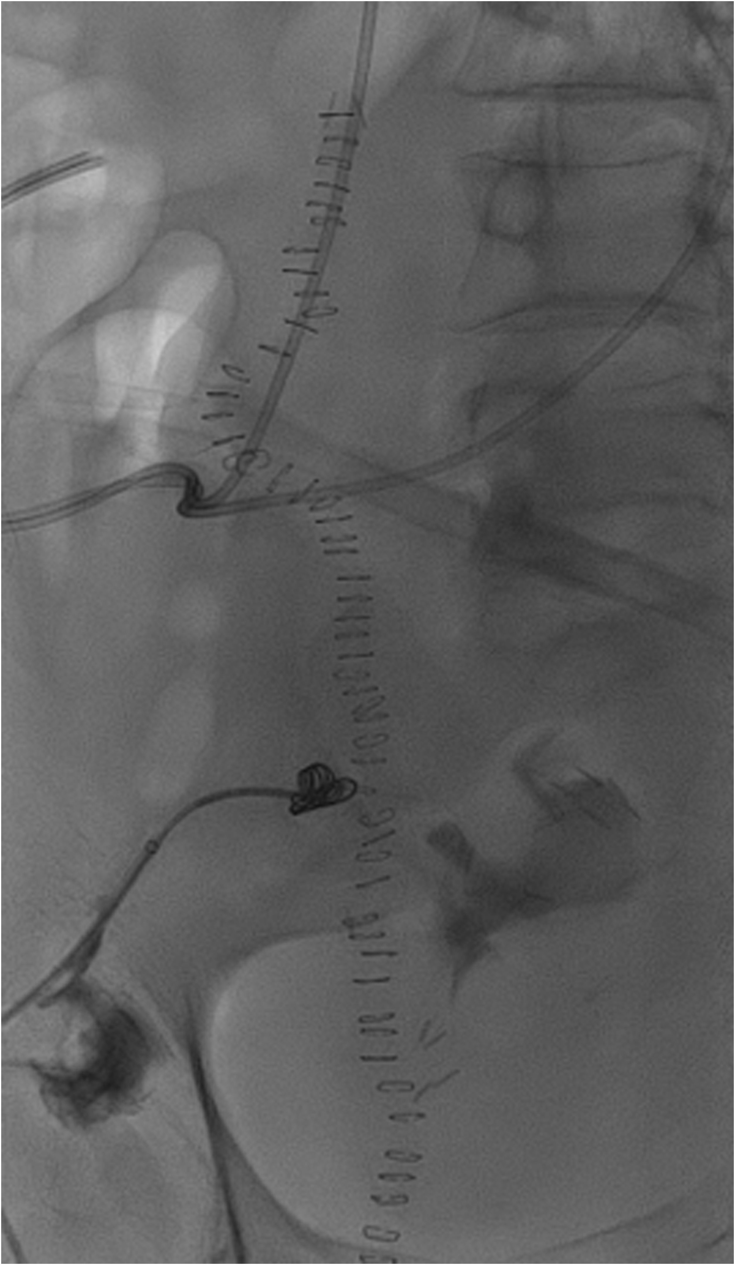 Inferior epigastric artery pseudoaneurysm rupture associated with drain ...