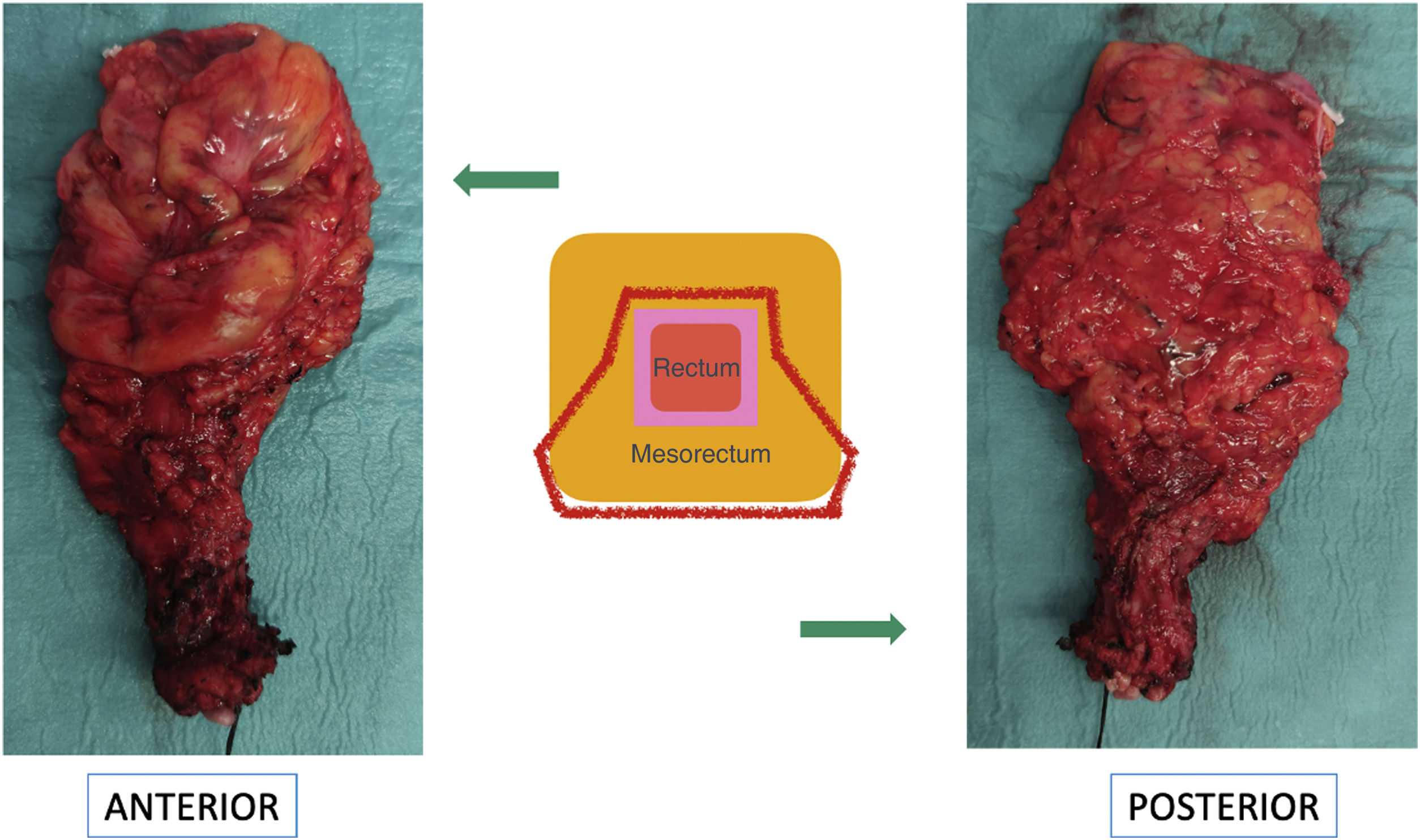 laparoscopic completion proctectomy