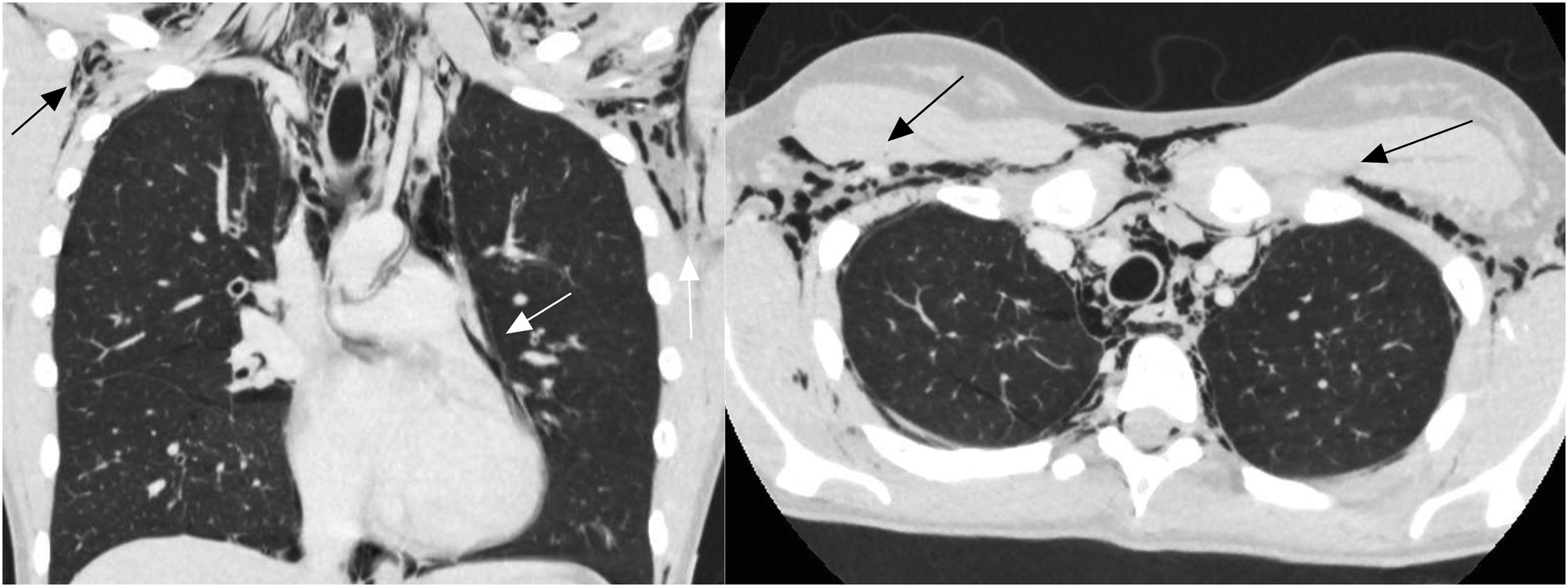 Spontaneous pneumomediastinum: Use of POCUS in the Emergency Department ...