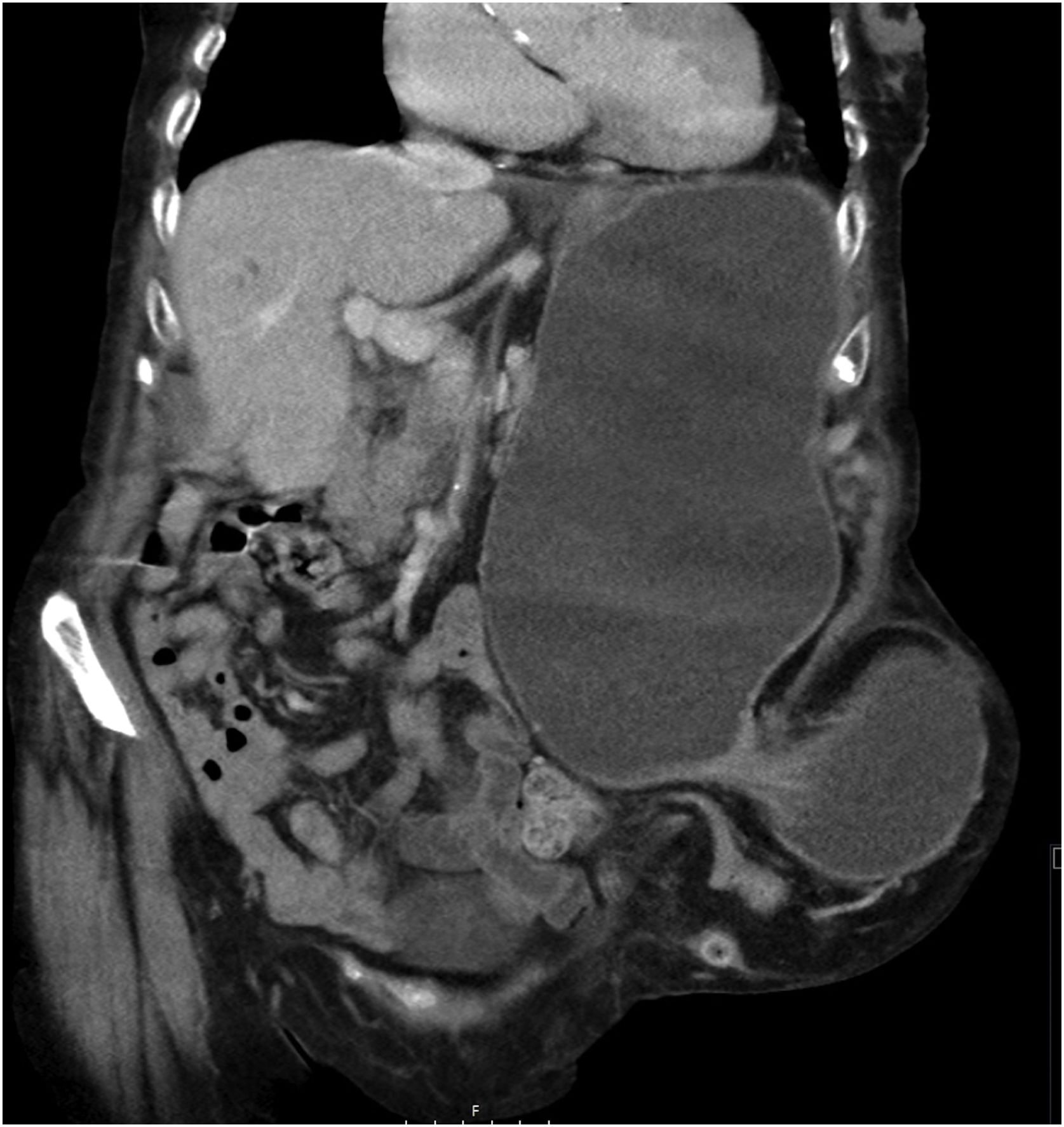 Gastric incarceration: A rare complication of parastomal hernia ...