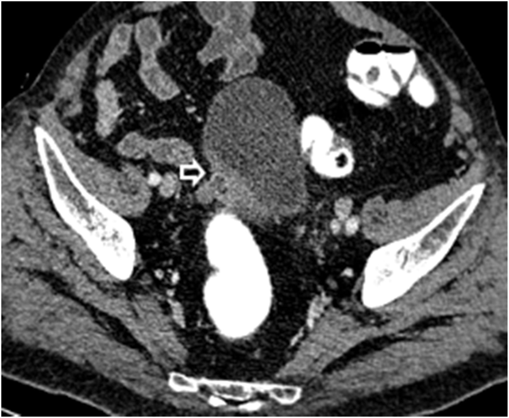 A rare form of enterovesical fistula: Appendicovesical fistula ...