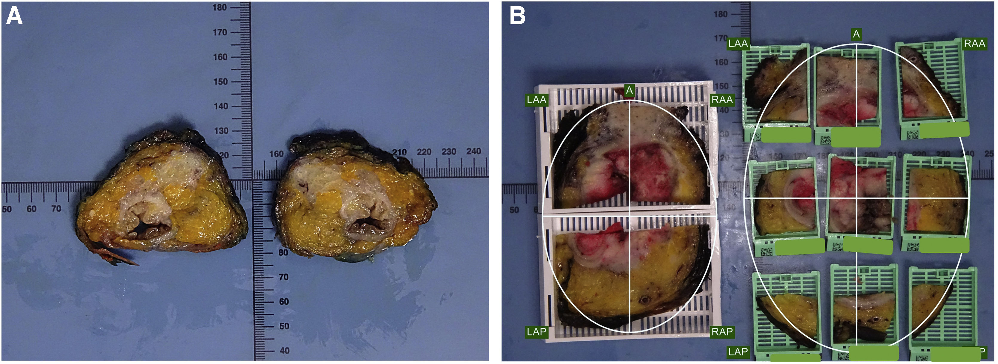 A comparison of whole-mount and conventional sections for pathological ...