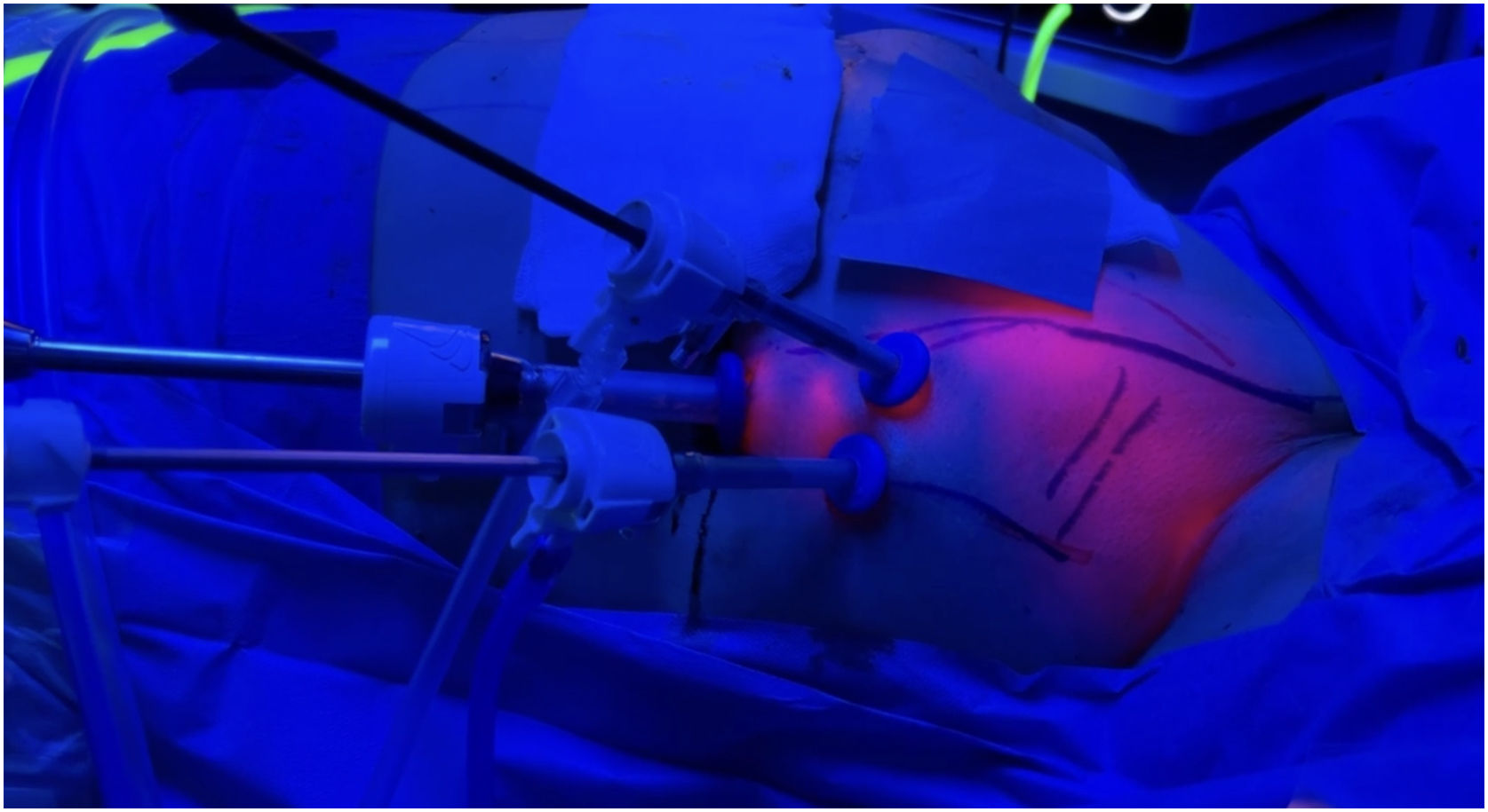 Endoscopic axillary lymphadenectomy: Tips & tricks | Cirugía Española ...