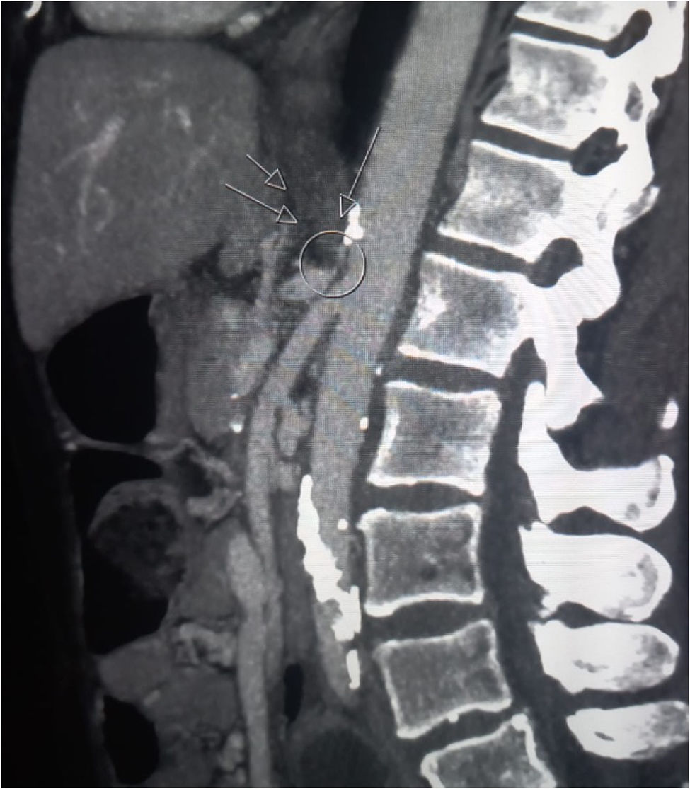 Median arcuate ligament syndrome: Step-by-step robot-assisted surgical ...