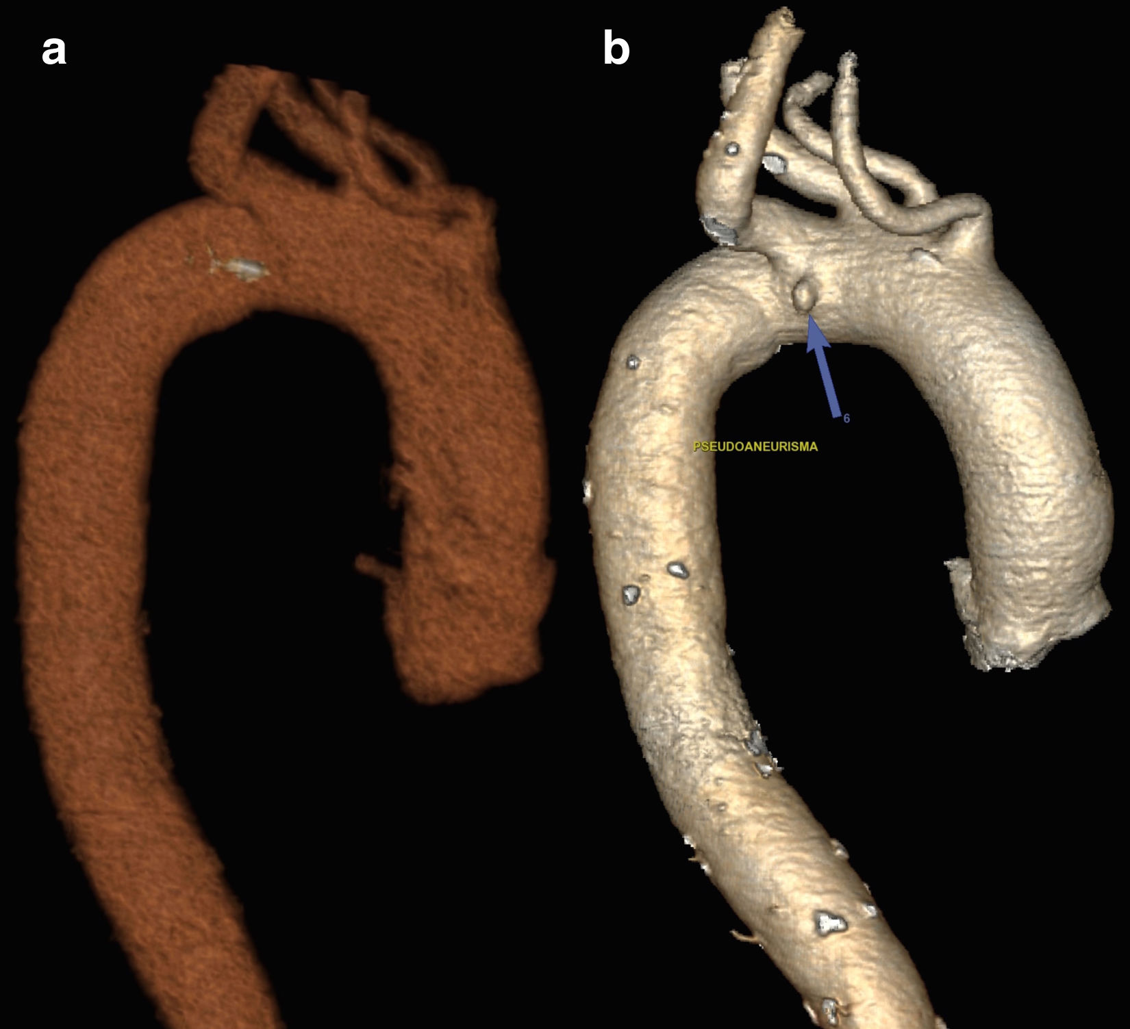 Post-traumatic pseudoaneurysm of the aortic arch due to esophageal ...