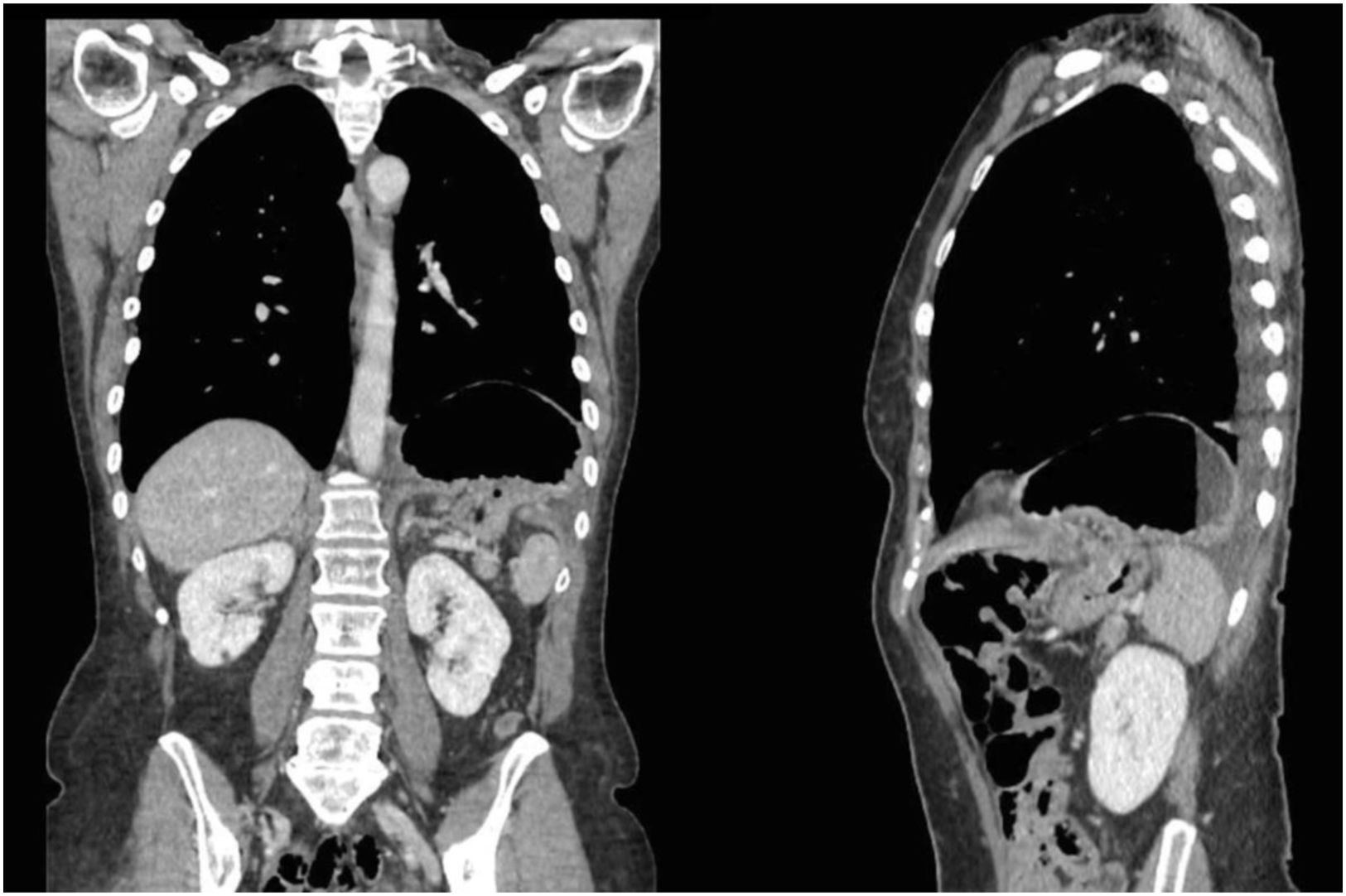 Minimally invasive repair of intrathoracic gastric volvulus: A delayed ...