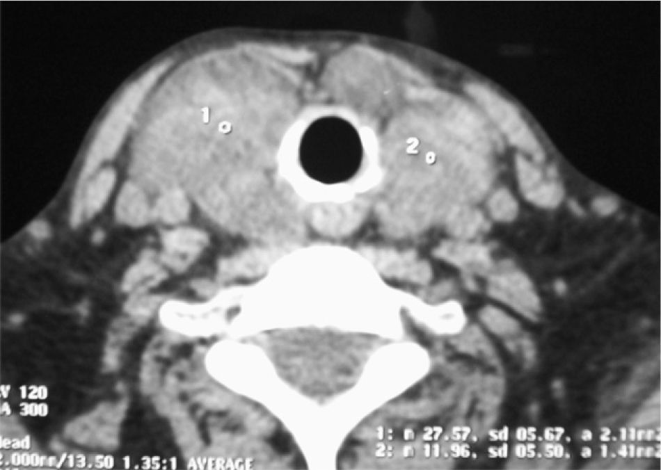 Amyloid goiter secondary to rheumatoid arthritis. A case report ...