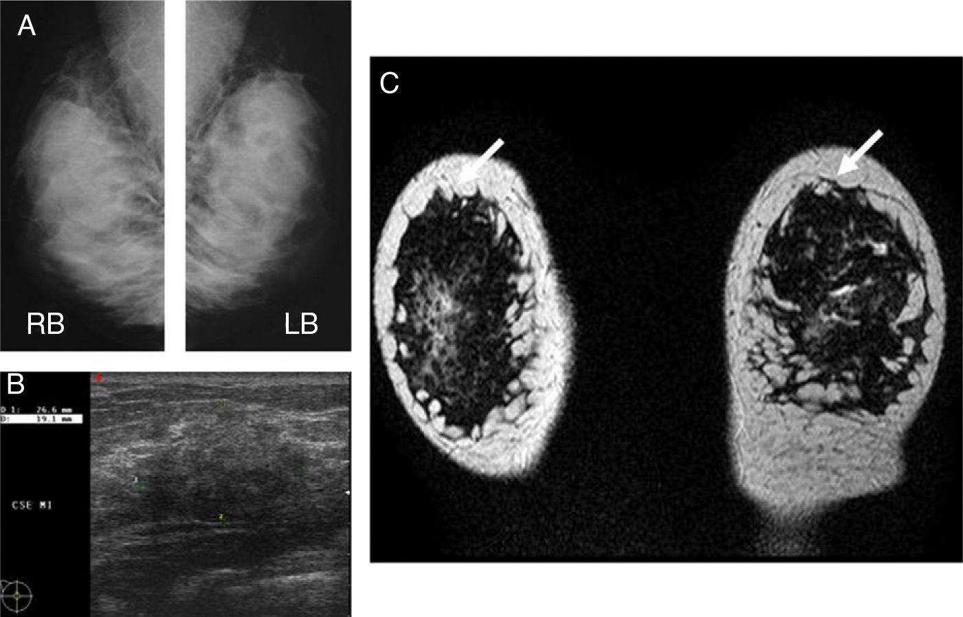Diabetic mastopathy: Clinical presentation, imaging and histologic ...