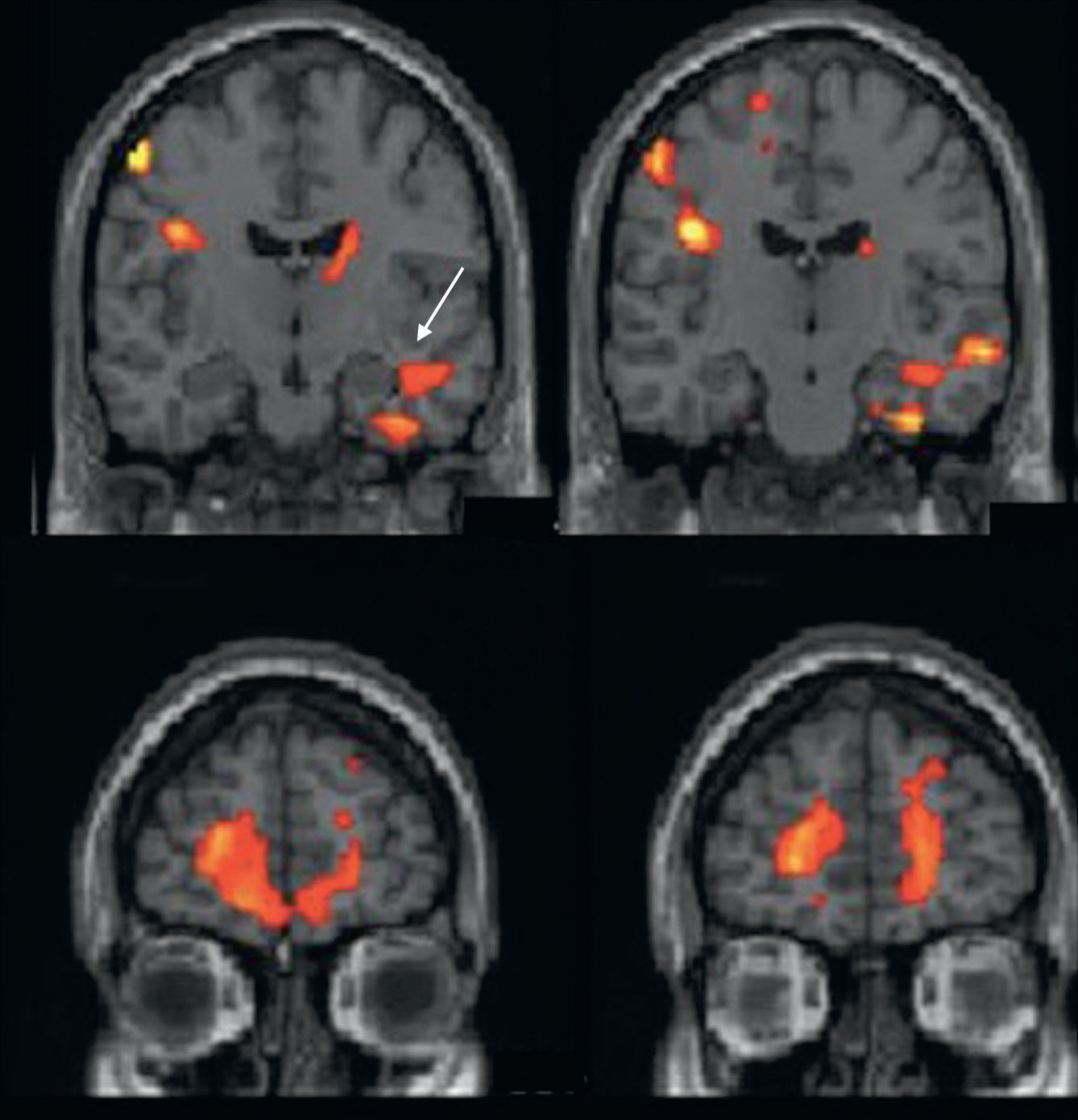 Imaging in epilepsy: Functional studies | Radiología (English Edition)