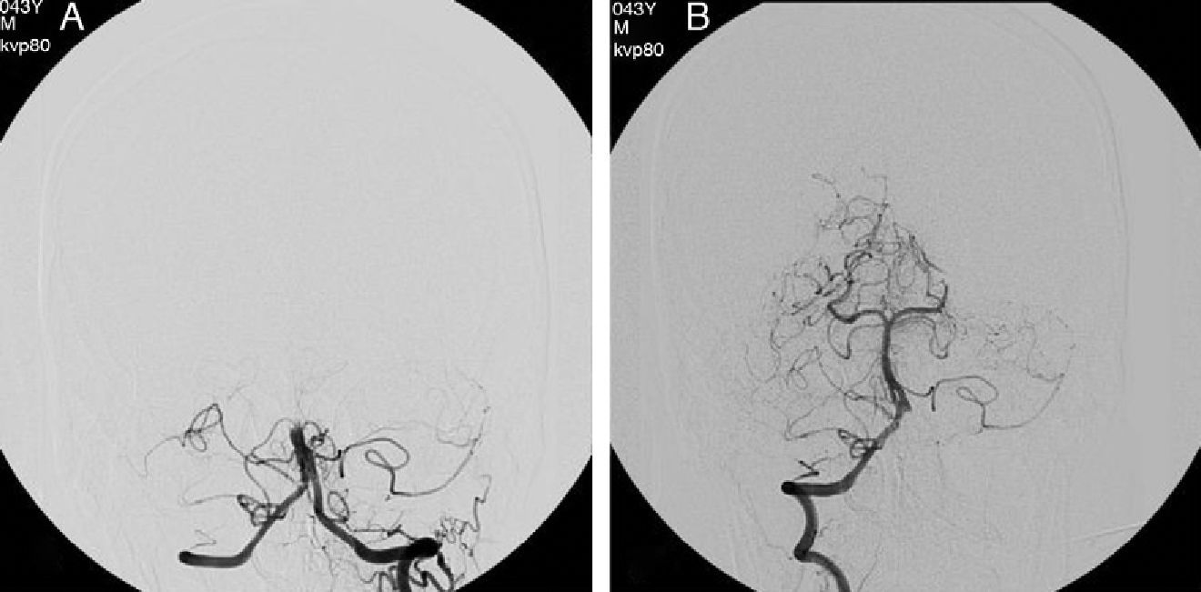 Vertebrobasilar recanalization modalities before the placement of stent ...