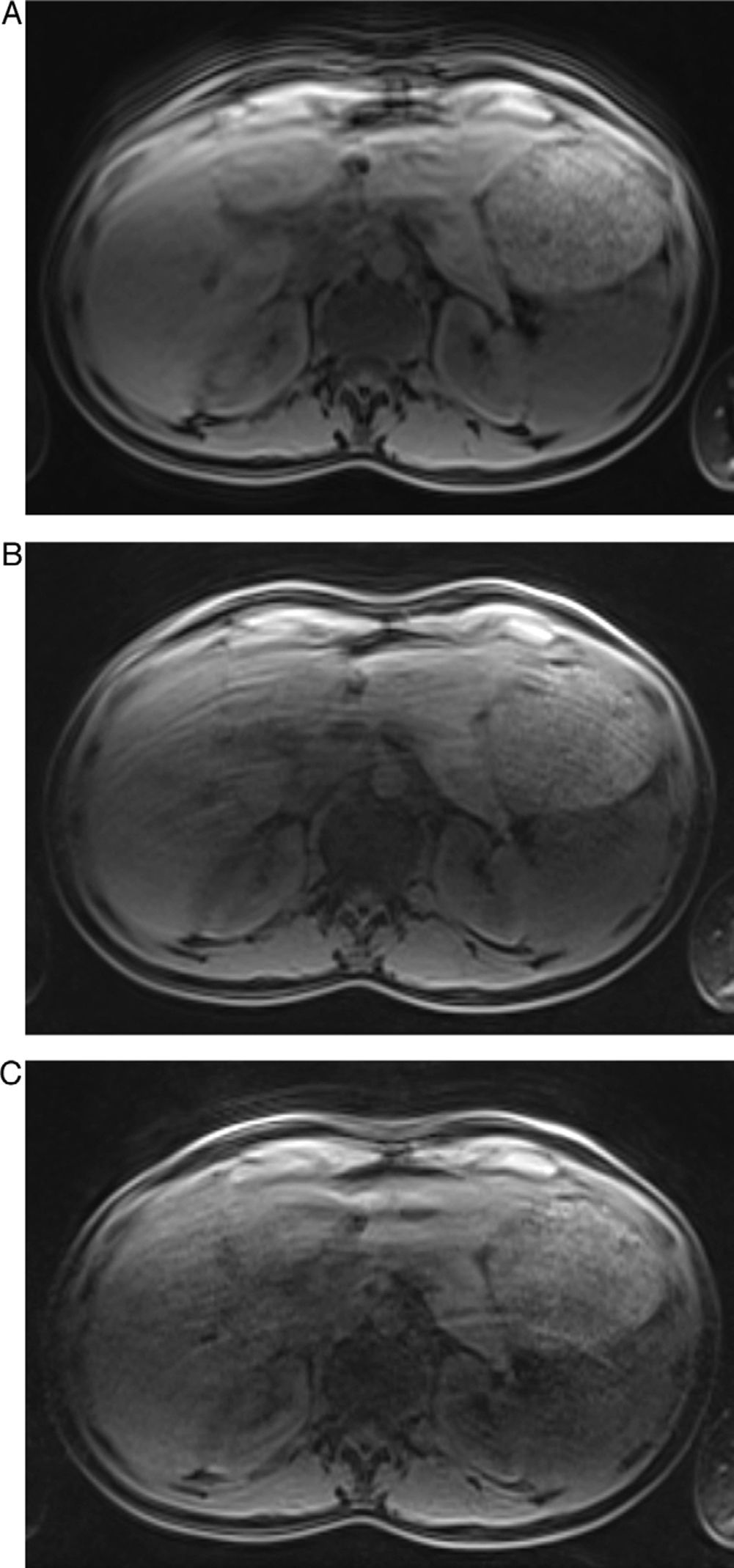 A comparison of a T1 weighted 3D gradient-echo sequence with three ...