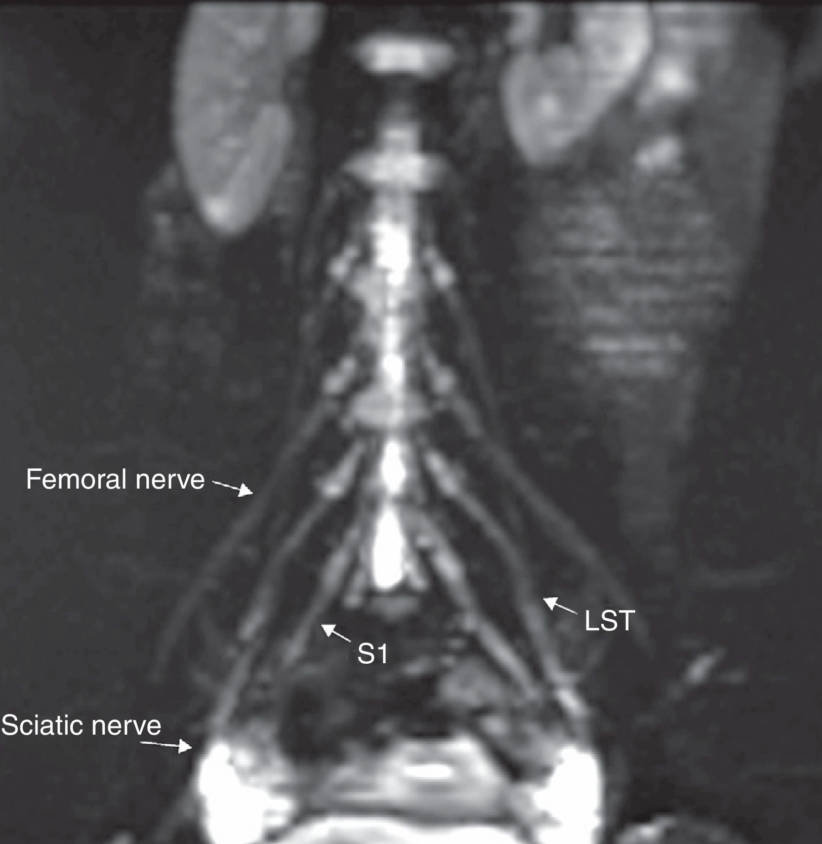High resolution neurography of the lumbosacral plexus on 3T magnetic ...