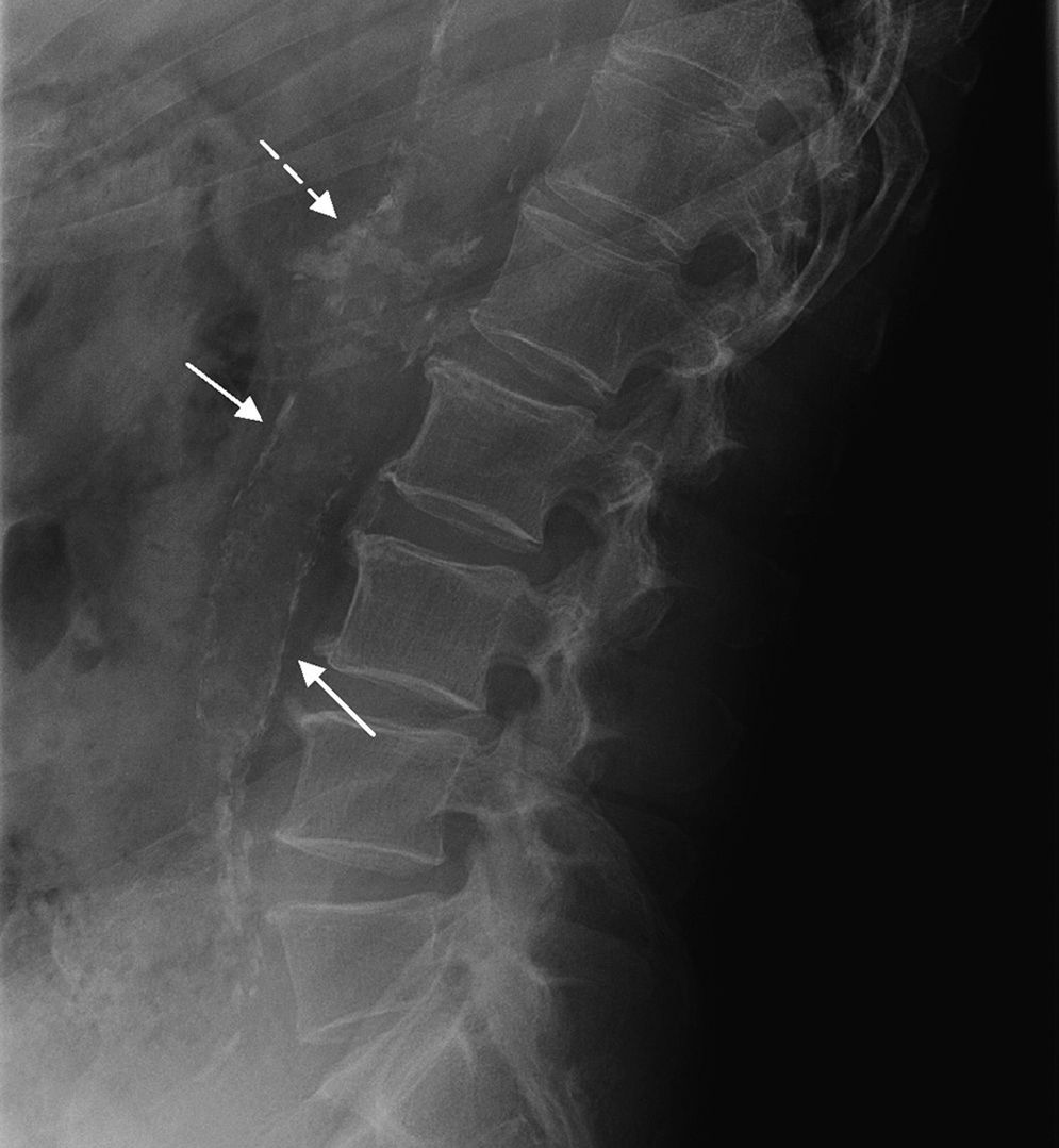 Reliability of radiologic evaluation of abdominal aortic calcification ...